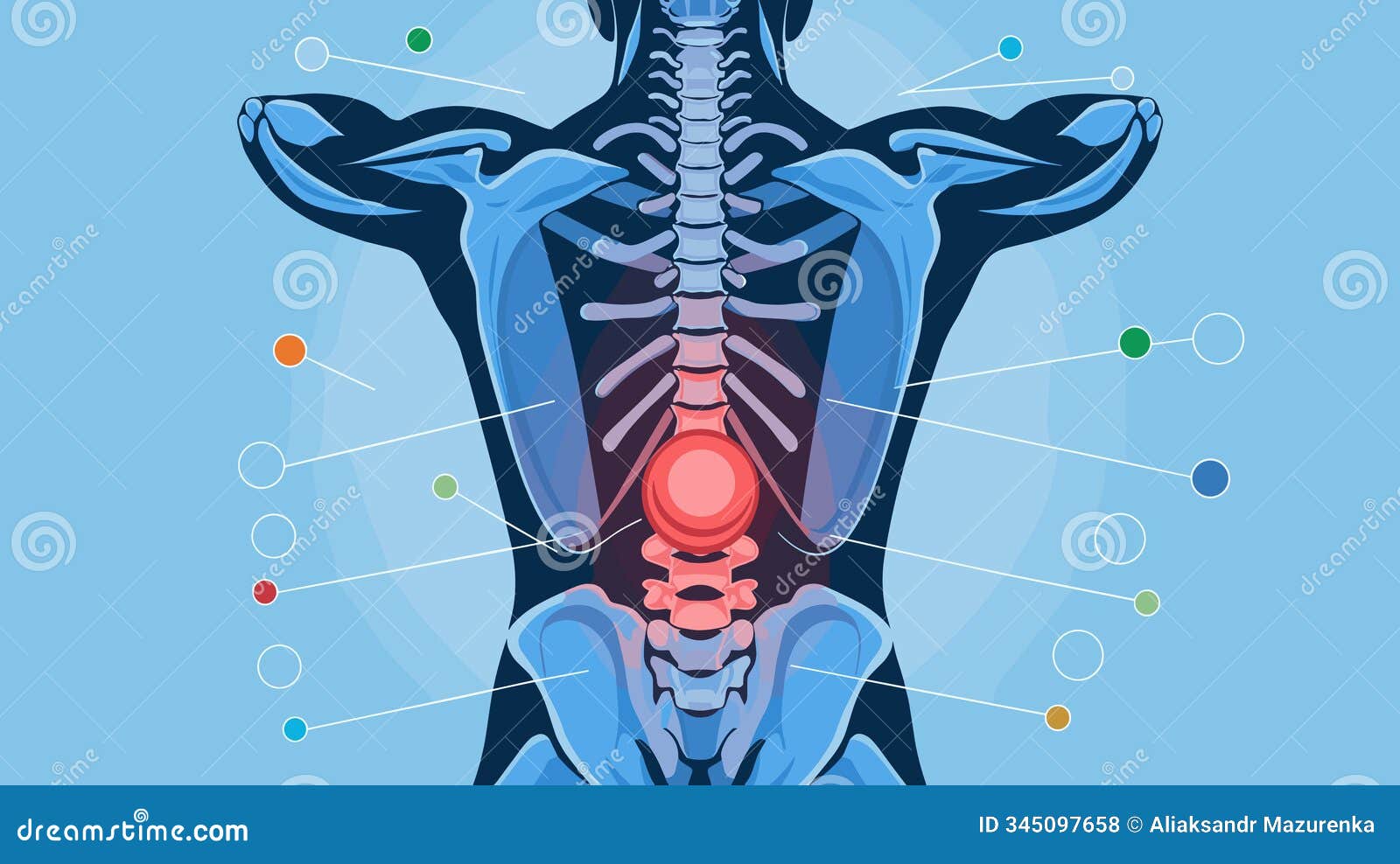 An Illustration of a Human Back with a Red Circle Marking a Herniated ...