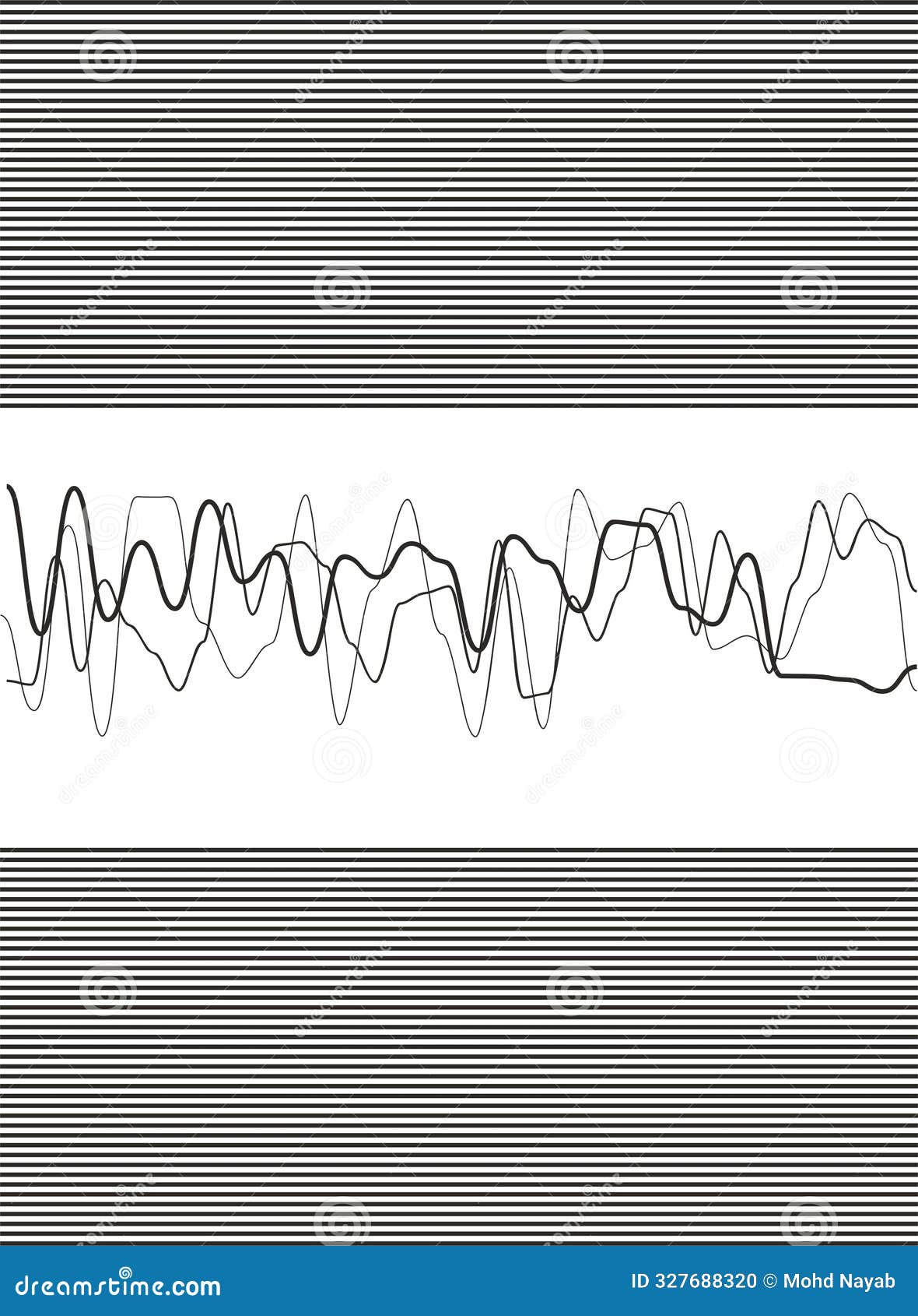 Illustration Of Ictal EEG Recording During Seizure Cartoon Vector ... Illustration Of Ictal EEG Recording During Seizure Cartoon Vector ...