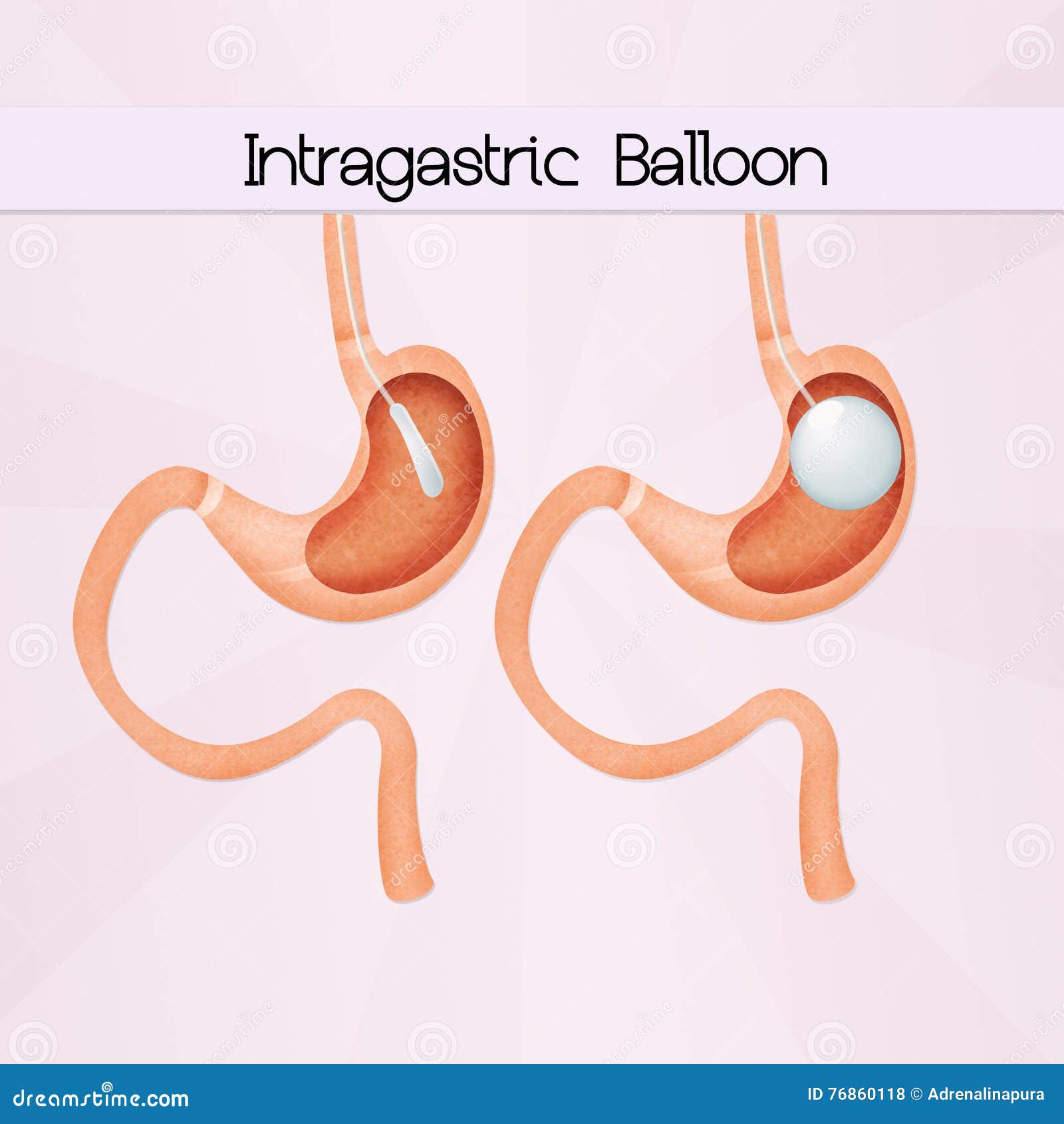 Intragastric Balloon Royalty-Free Stock Photography | CartoonDealer.com ...