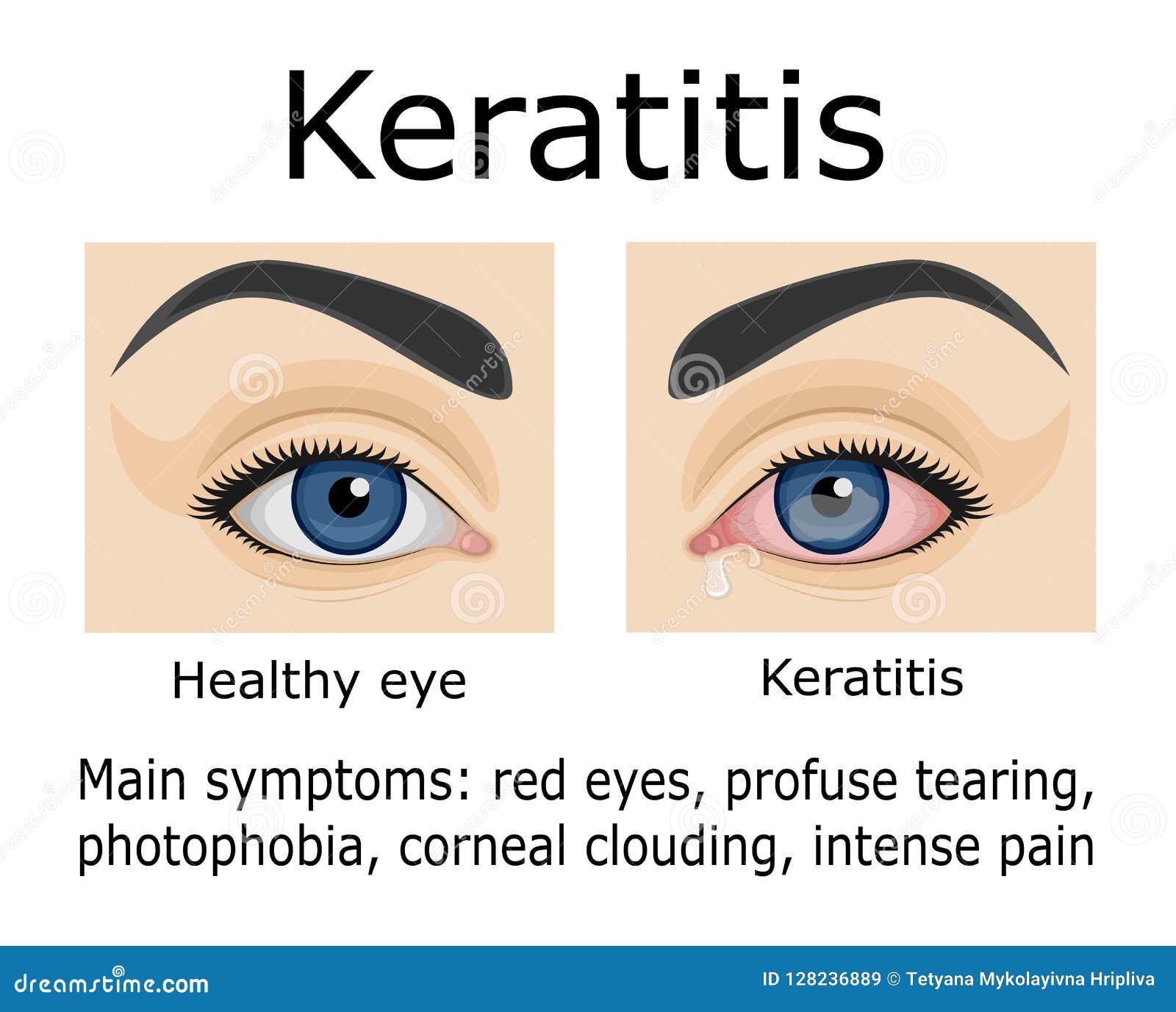 Keratitis Cartoons, Illustrations & Vector Stock Images - 216 Pictures ...