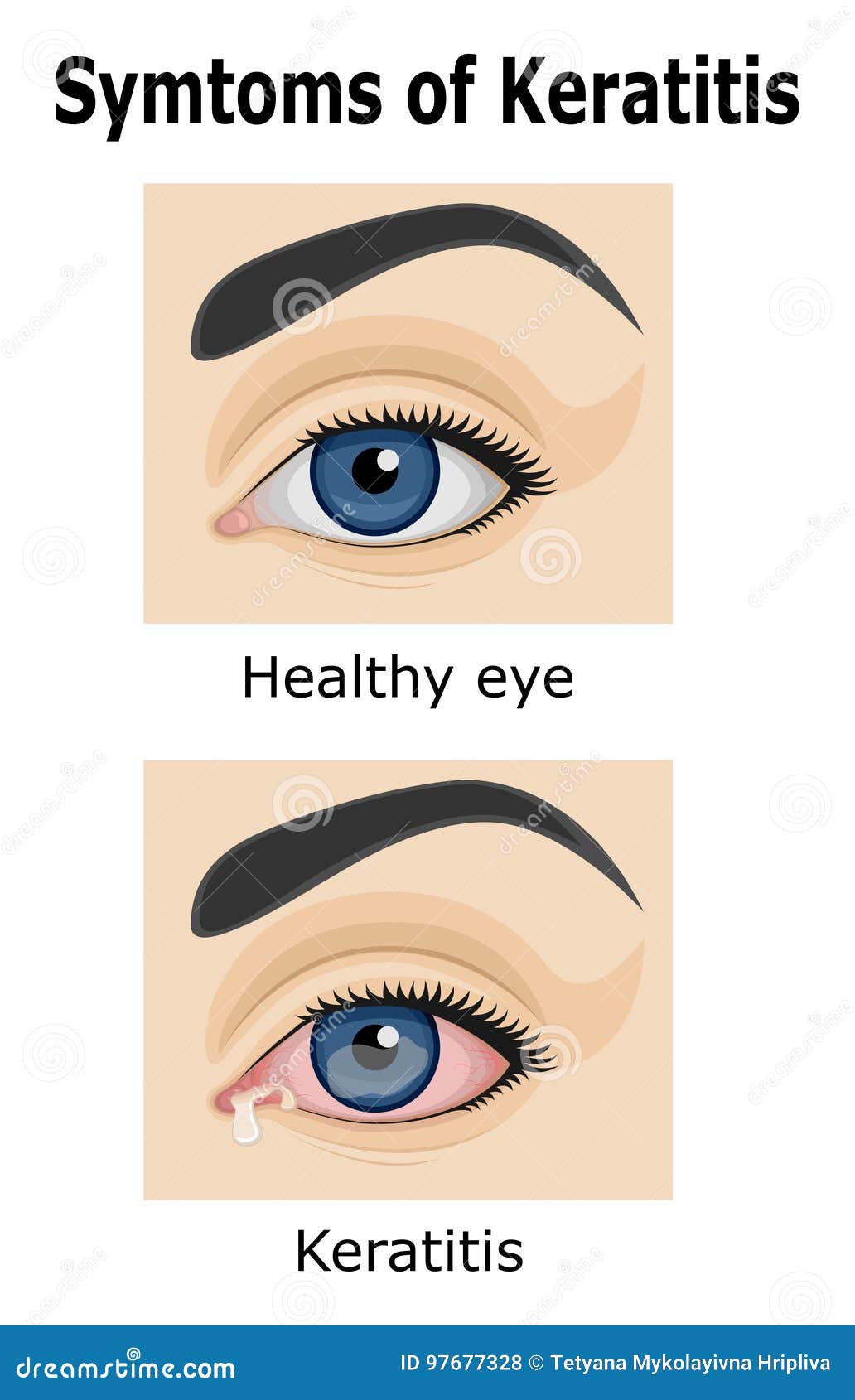 Keratitis Cartoons, Illustrations & Vector Stock Images - 216 Pictures ...