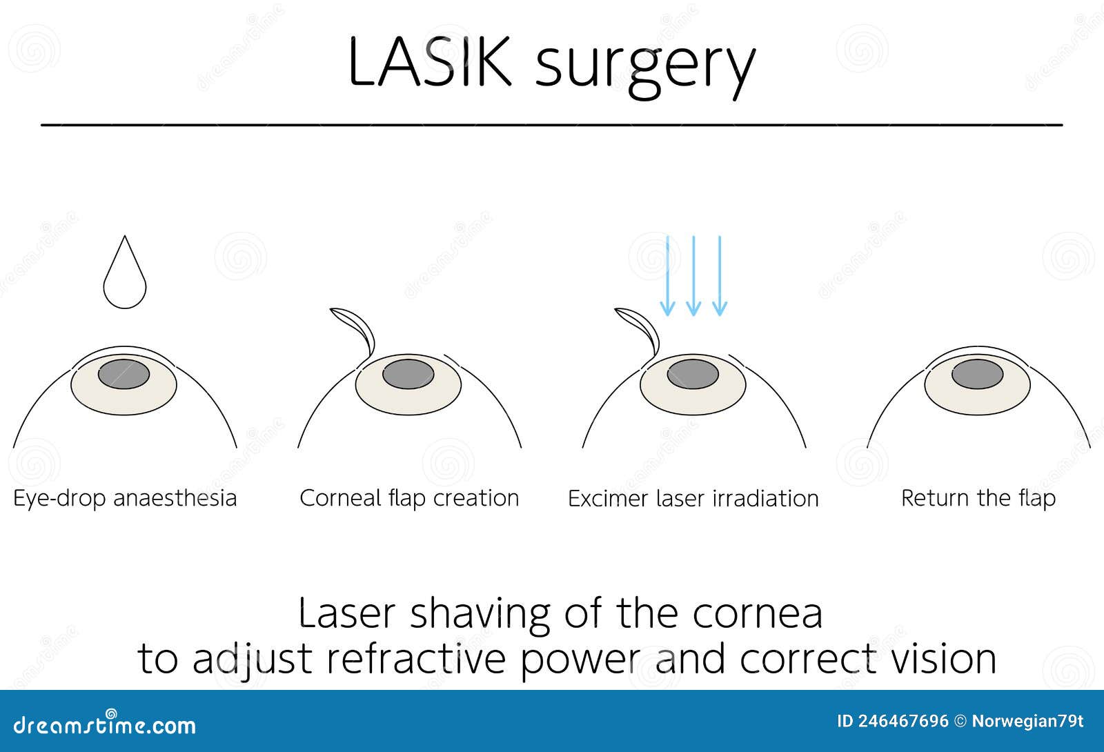 Illustration Lasik Correction De Vision Illustration Médicale ...