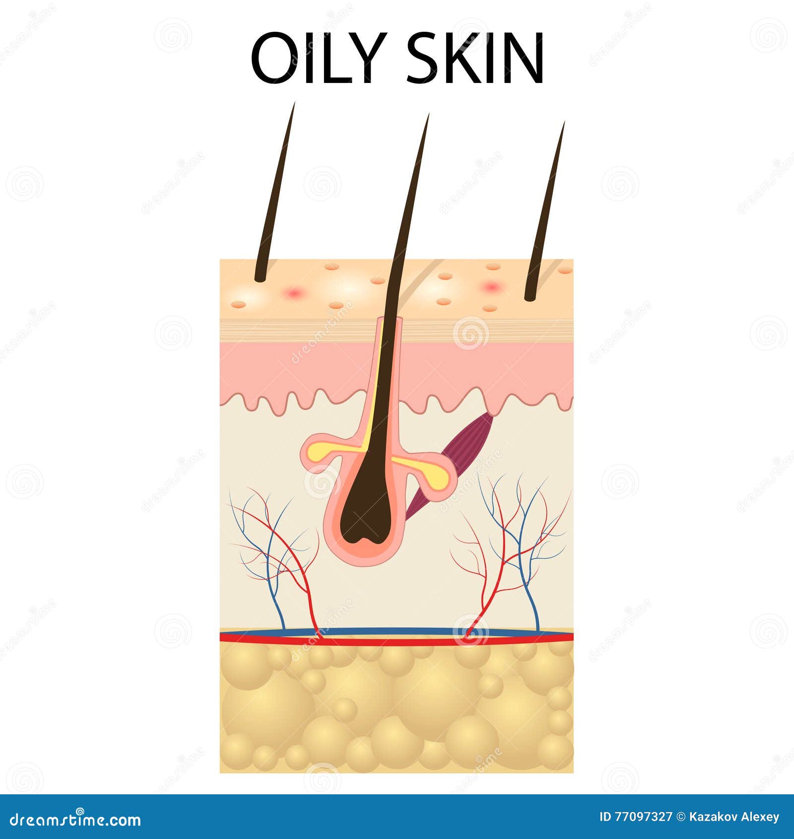 Oily Skin Cross-section Of Human Skin Layers Structure Skincare Medical ...