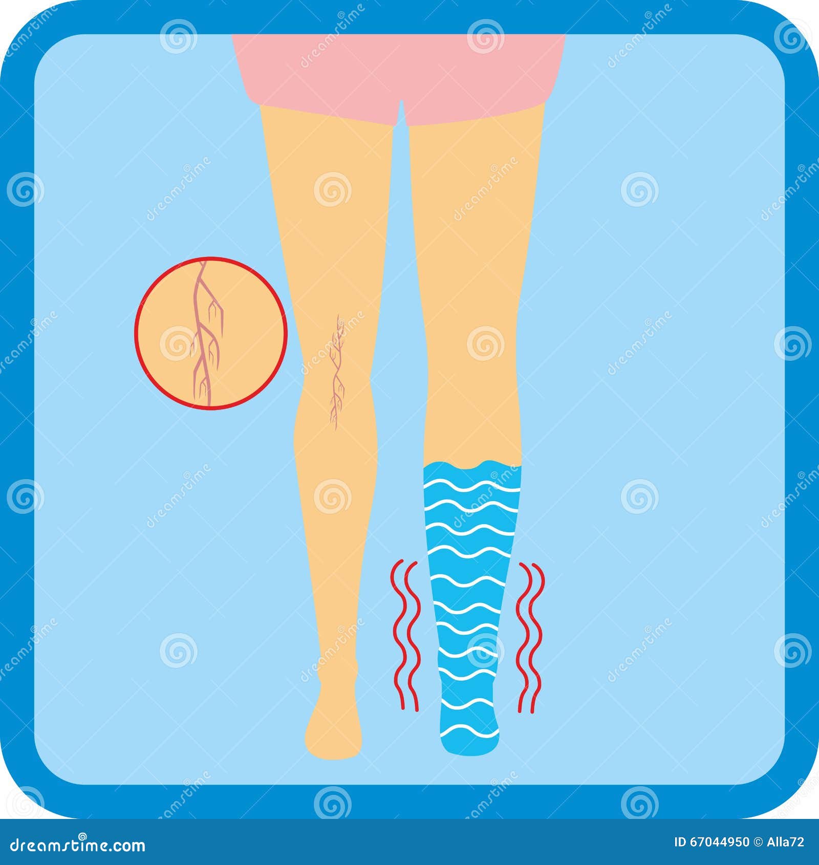 Edema Symptoms And Treatment Landing Page Template. Tiny Doctor ...