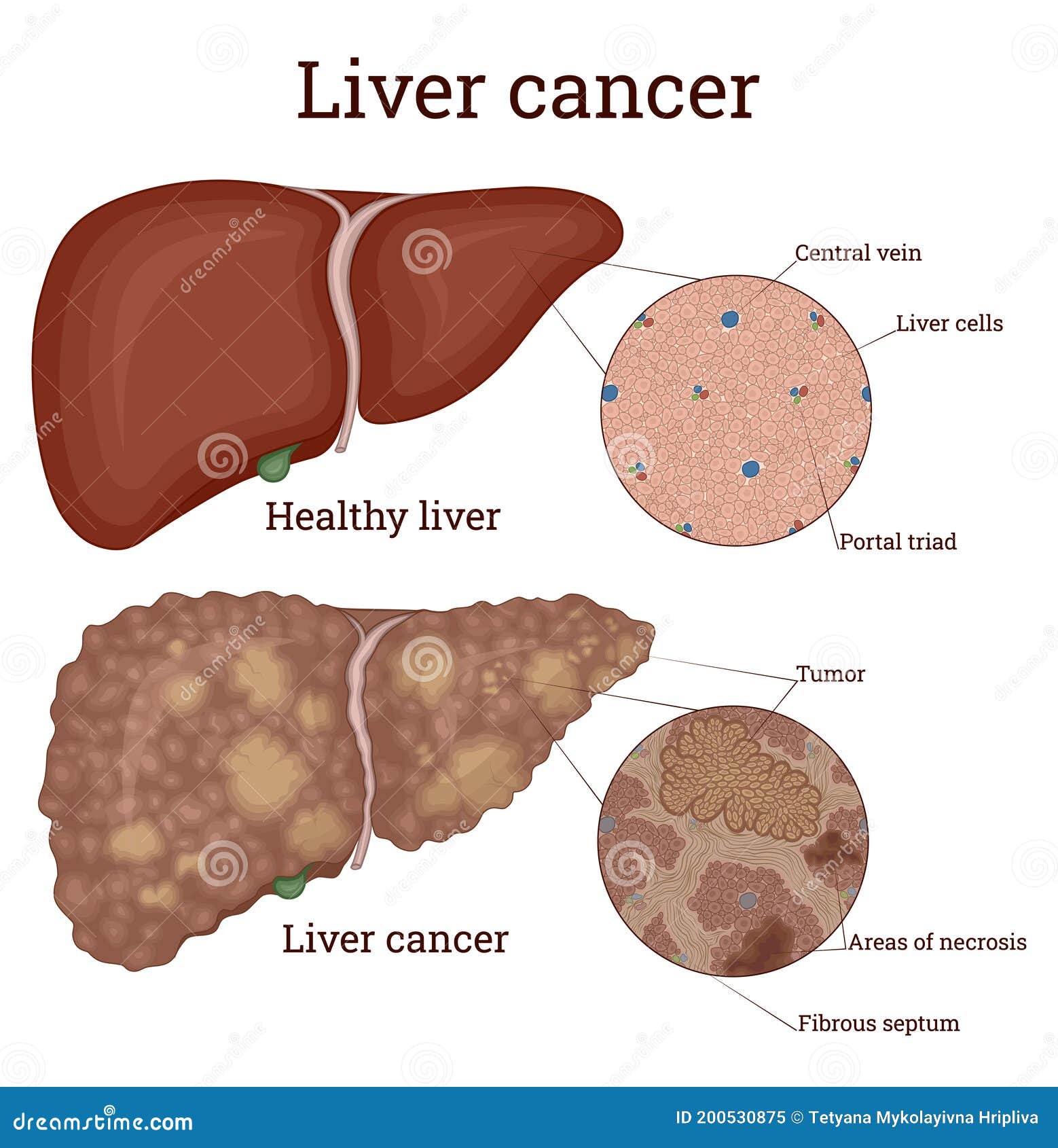 Illustration of the Liver Cancer Stock Vector - Illustration of ...