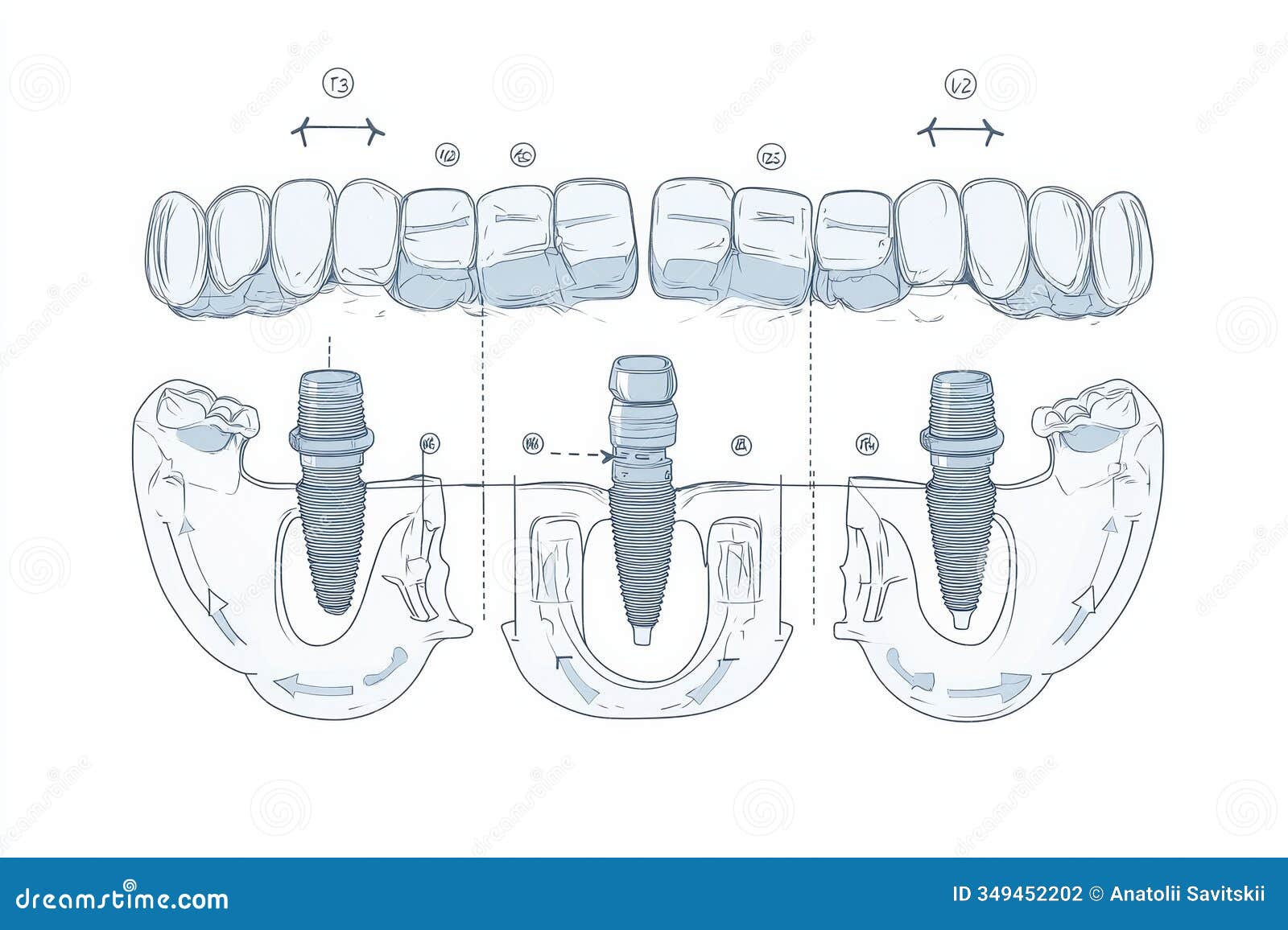 Illustration Outlines the Three Key Stages of Dental Implant Placement ...