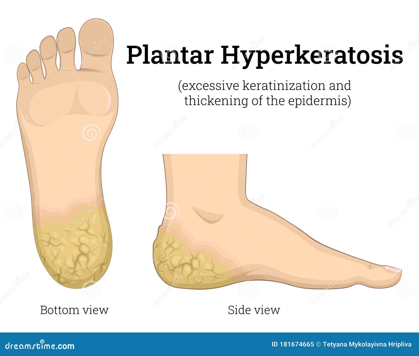 Illustration of Plantar Hyperkeratosis Stock Vector - Illustration of ...
