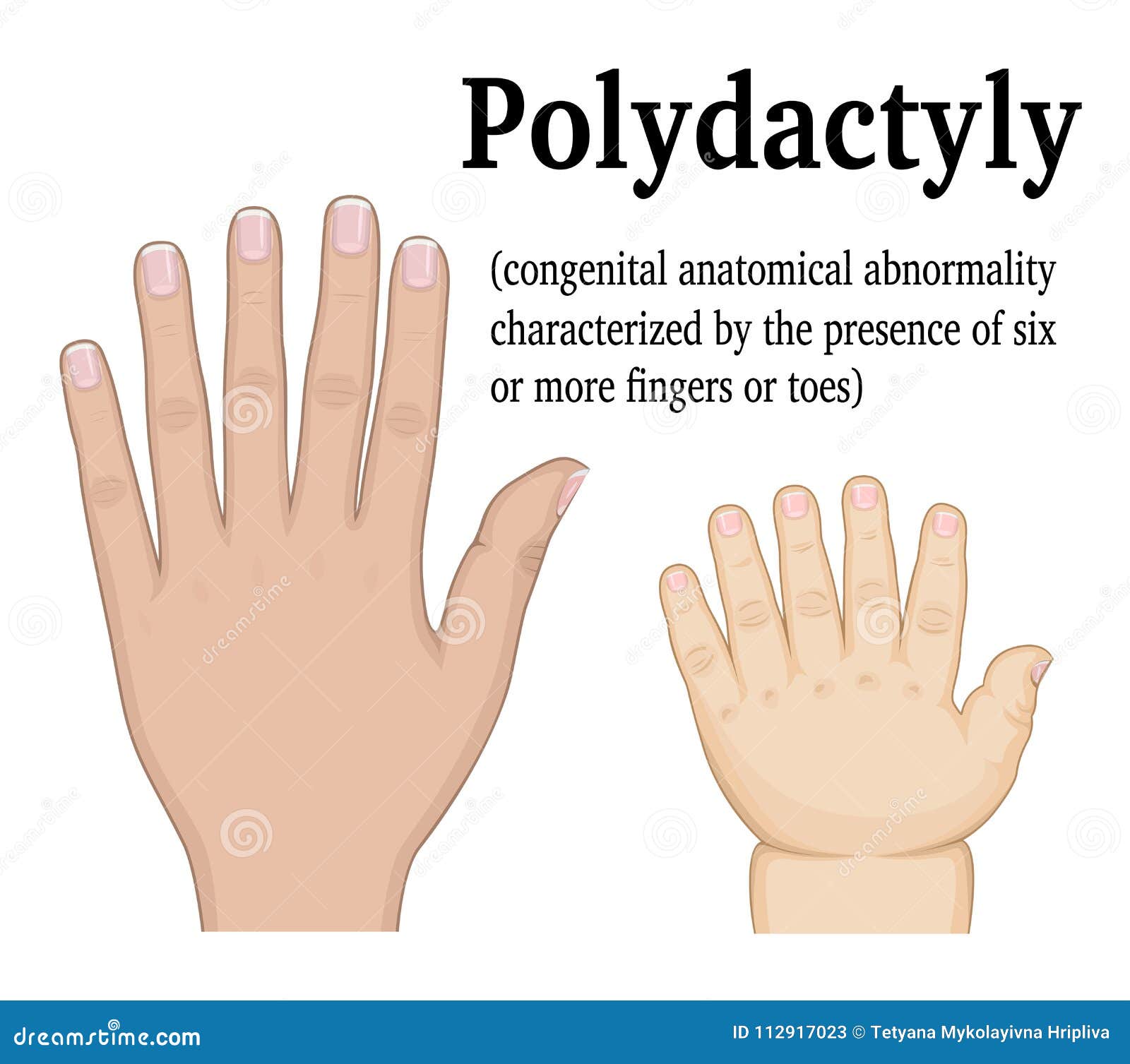 Polydactyly Illustration Stock Illustrations – 7 Polydactyly ...