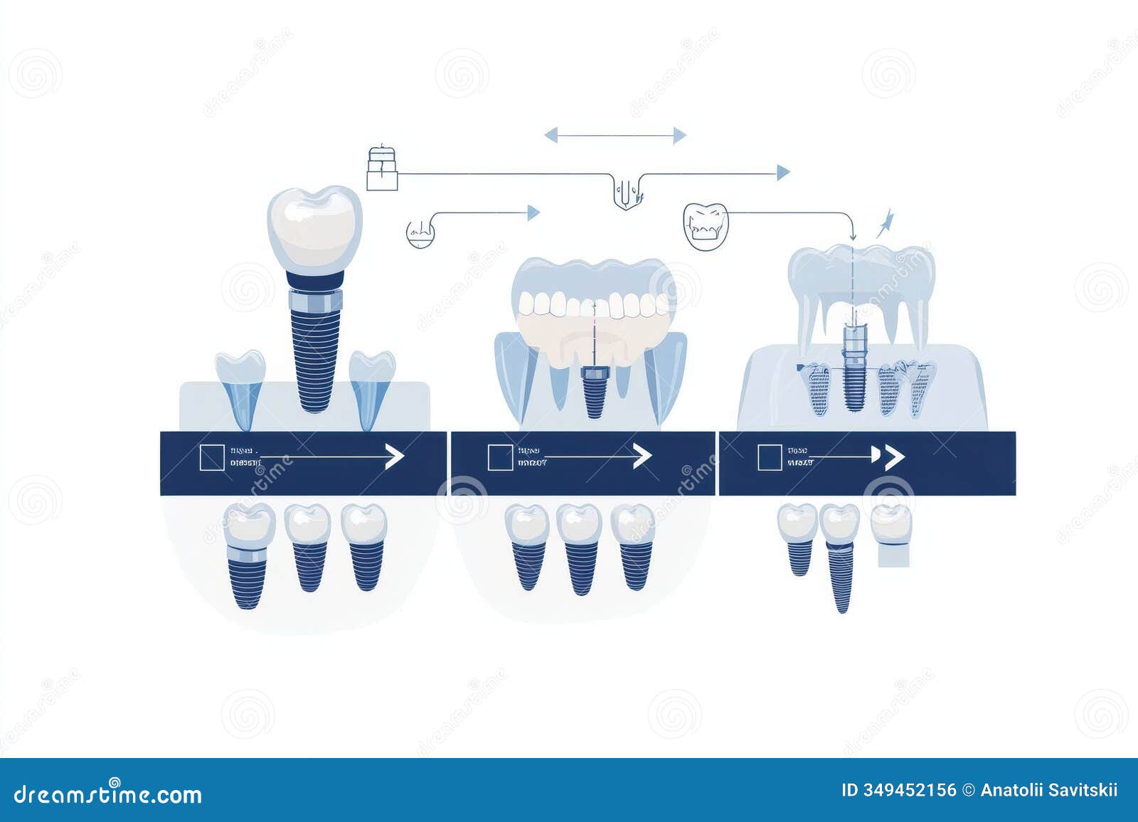 This Illustration Presents a Clear, Step-by-step Guide To the Dental ...