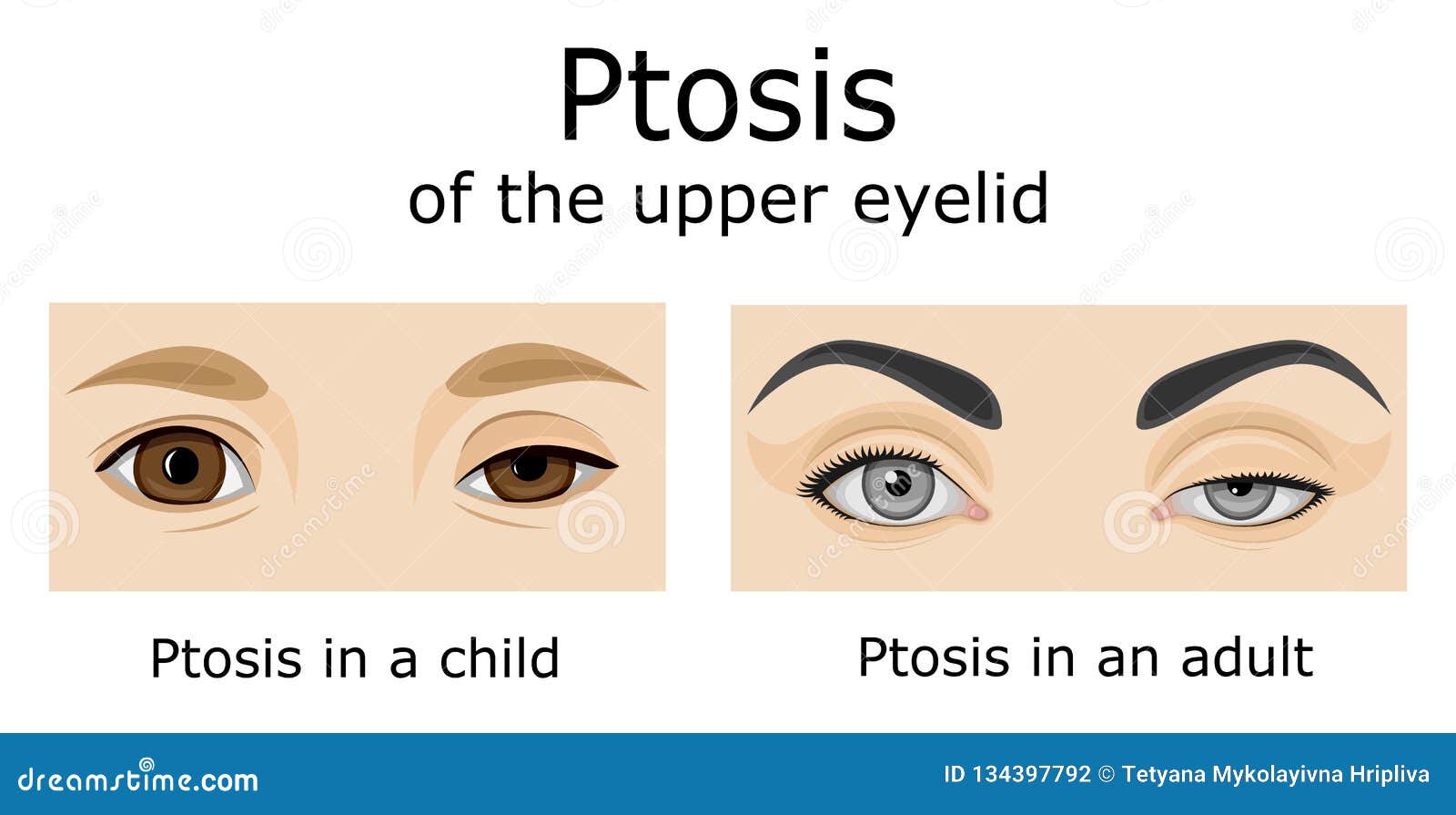 Illustration Of Ptosis Of The Upper Eyelid Stock Vector Illustration Of Acquired Disease