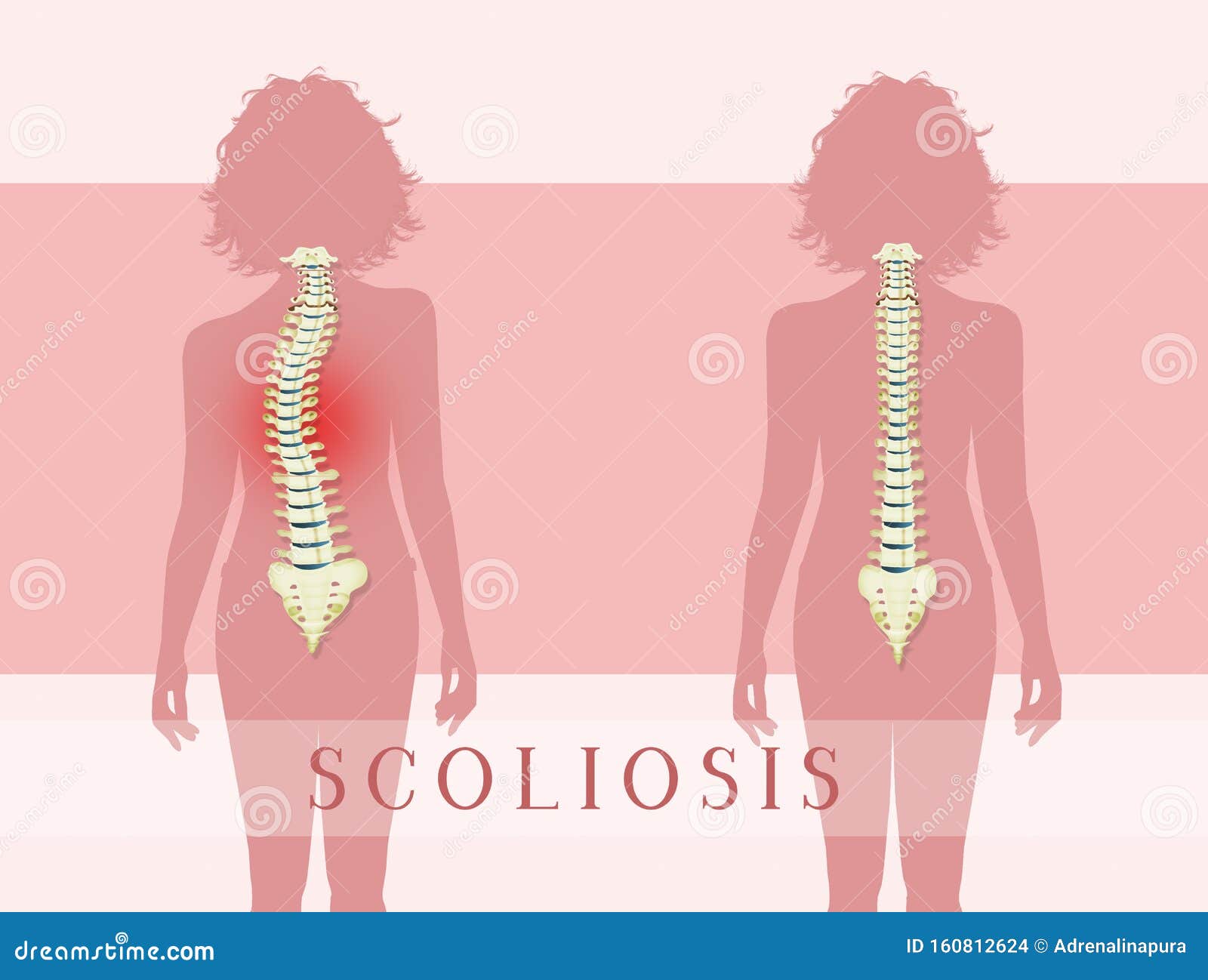 Illustration of scoliosis stock illustration. Illustration of ...