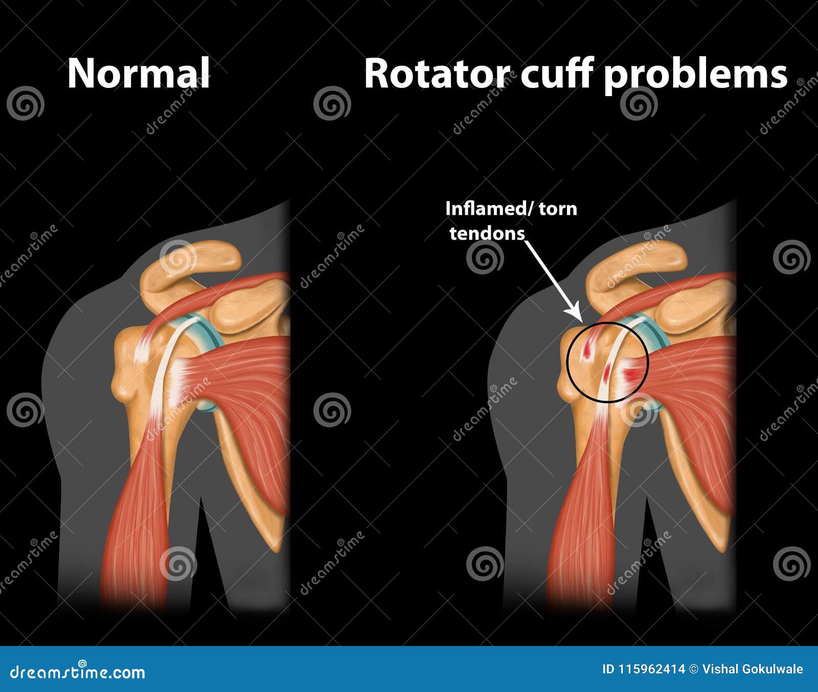 Shoulder-Impingement stock illustration. Illustration of care - 115962414 Shoulder-Impingement stock illustration. Illustration of care - 115962414