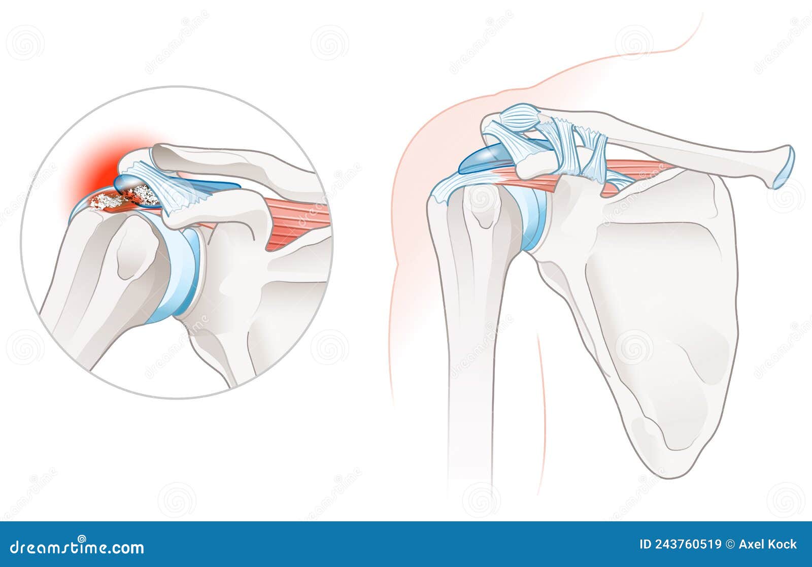 Calcific Tendinitis Shoulder Illustration. Labeled Stock Image ...