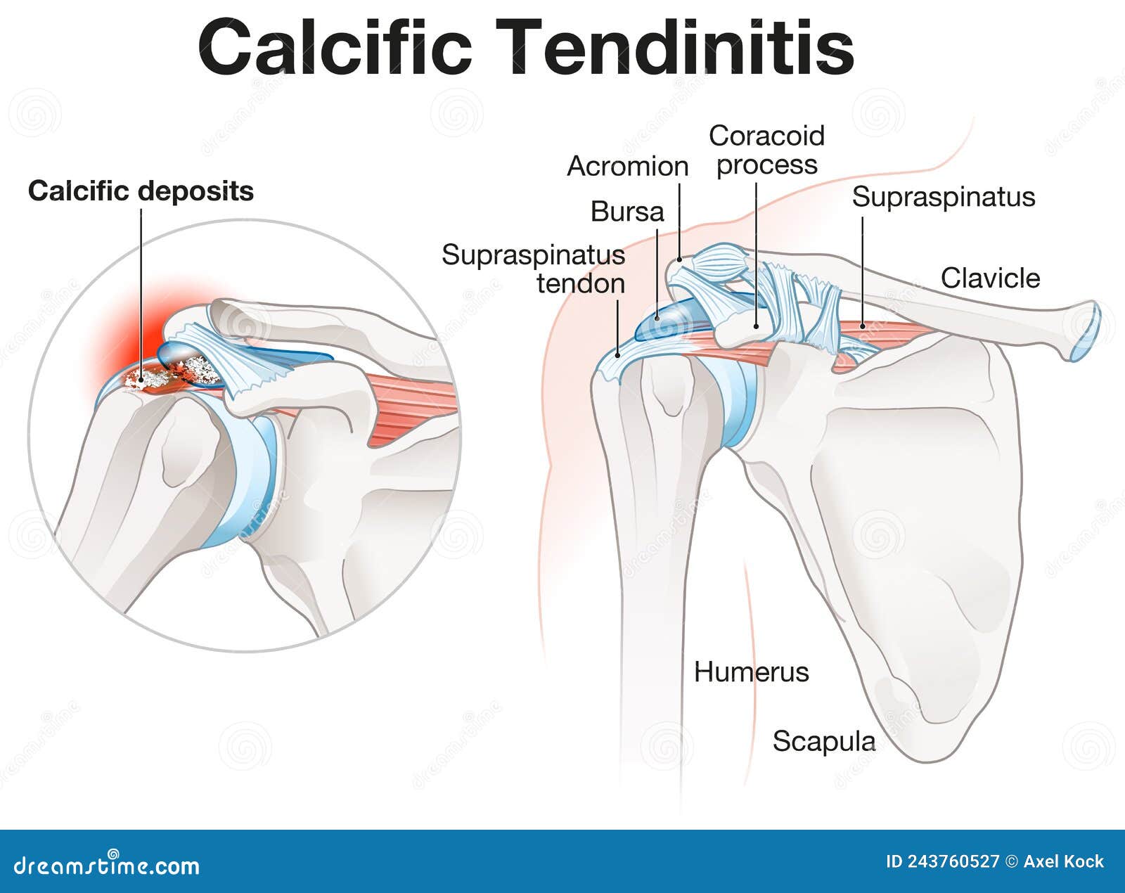 Shoulder Impingement. Painful Arc. Labeled Illustration Stock Photo ...