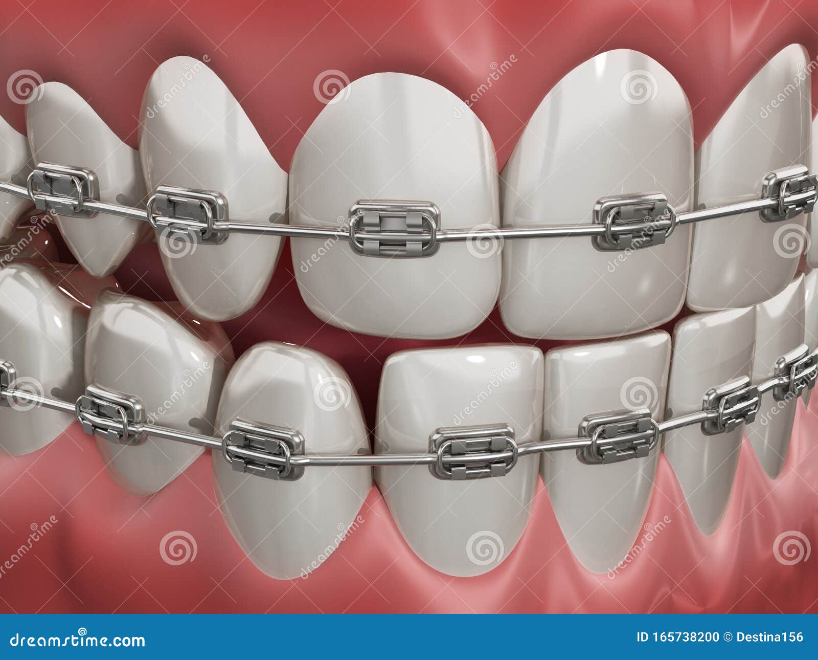 Illustration Showing Dental Braces on Straight Teeth. 3D Illustration ...