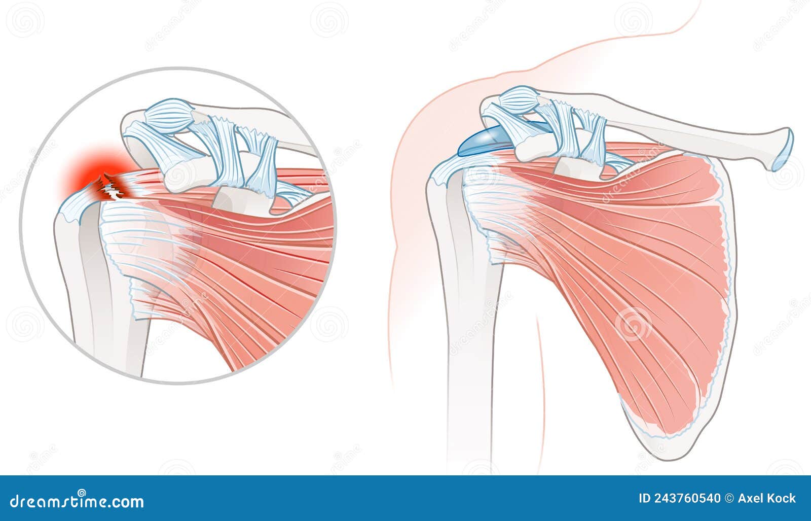 Rotator Cuff Tear Shoulder Illustration Stock Illustration ...