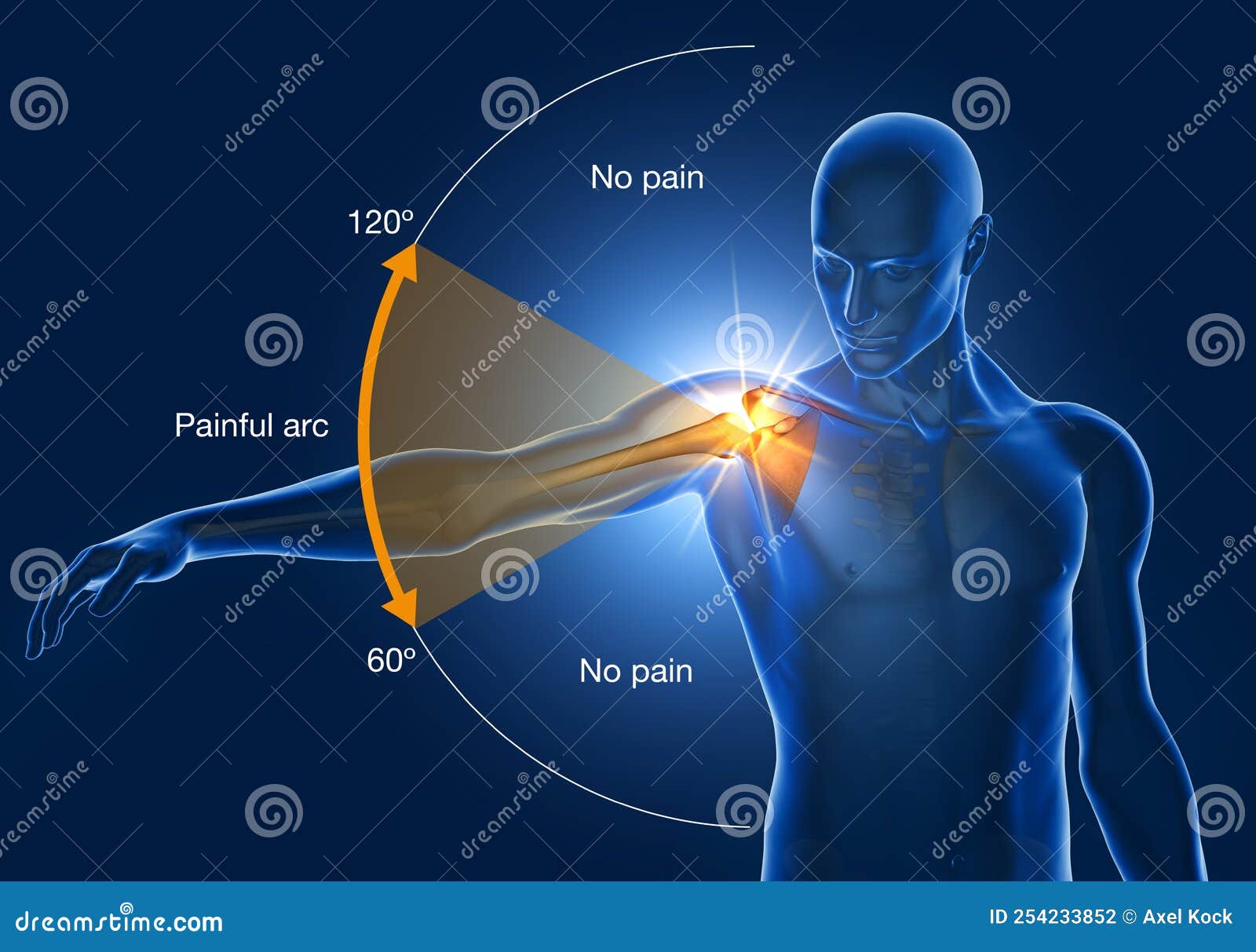 Shoulder Impingement. Painful Arc. Labeled Illustration Stock Photo ...