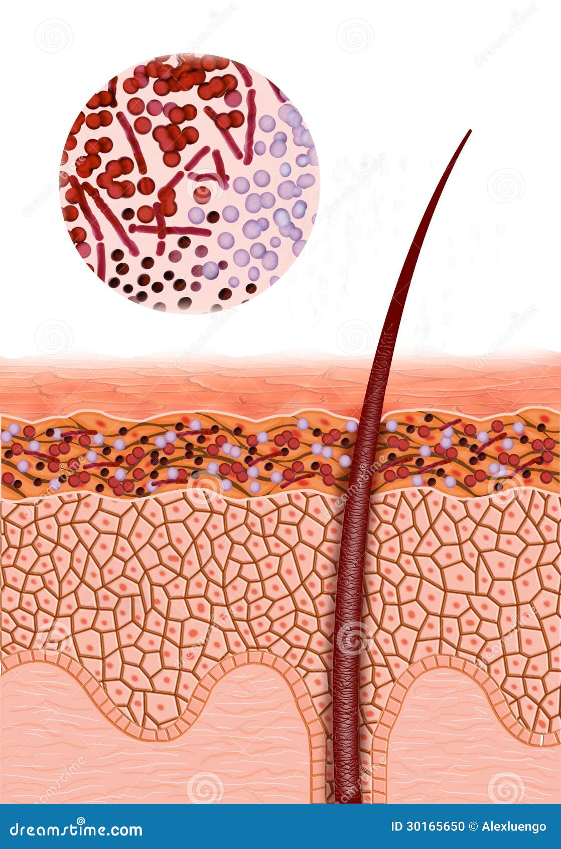 The Skin Affected By Ringworm Pink. Pityriasis Rosea. Vector ...