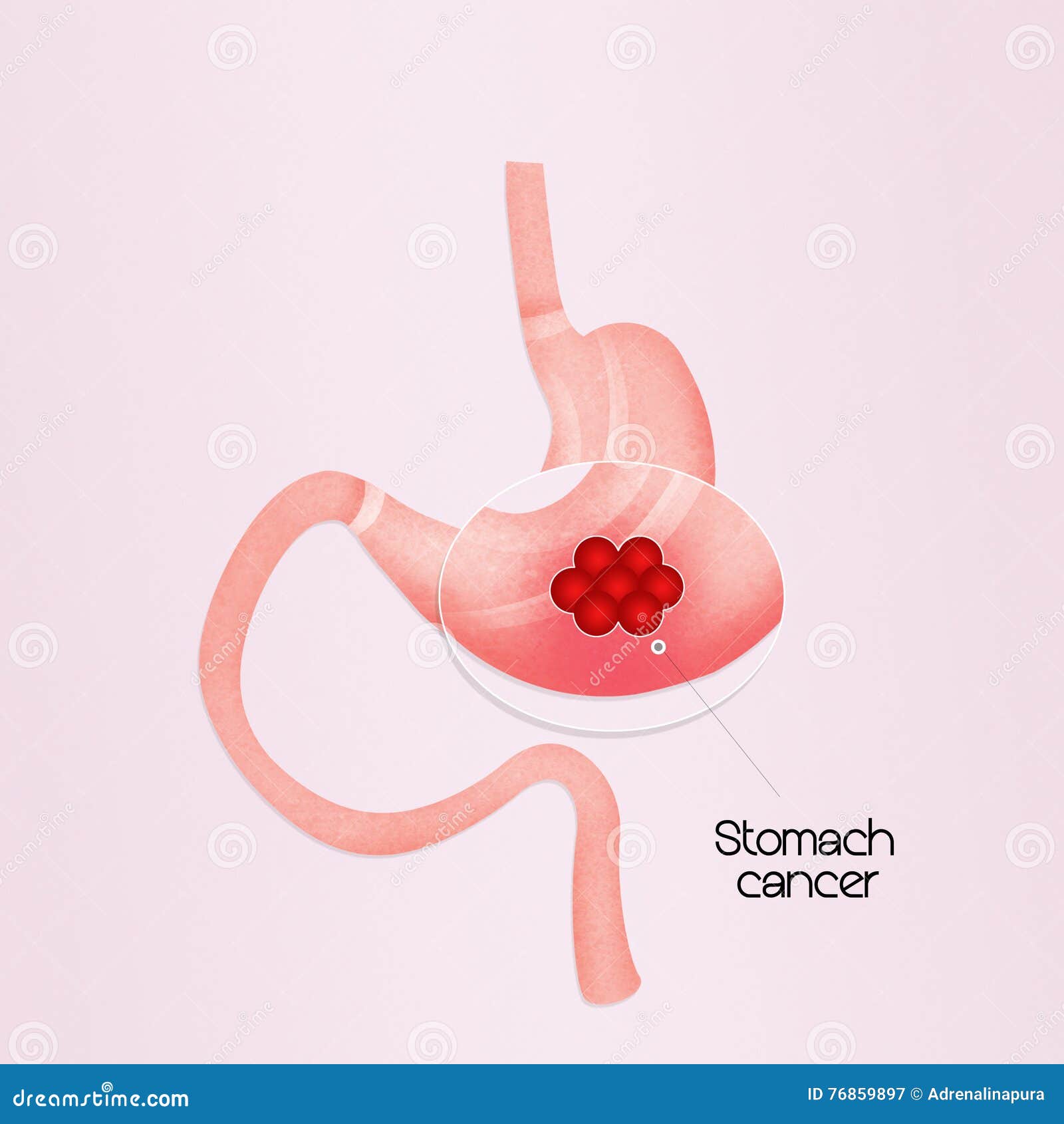 Illustration of Stomach Cancer Stock Illustration - Illustration of ...