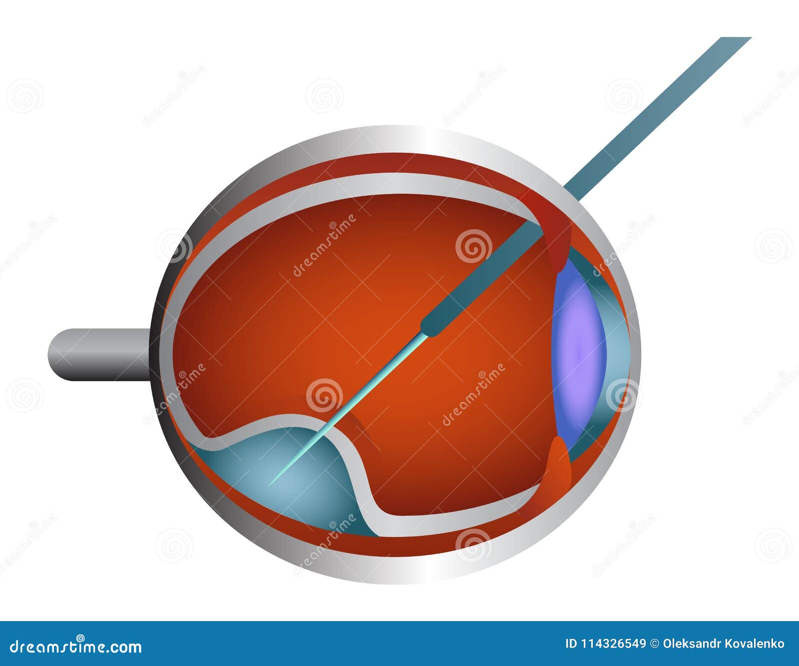 Vector Illustration of the Subretinal Injection Stock Vector ...
