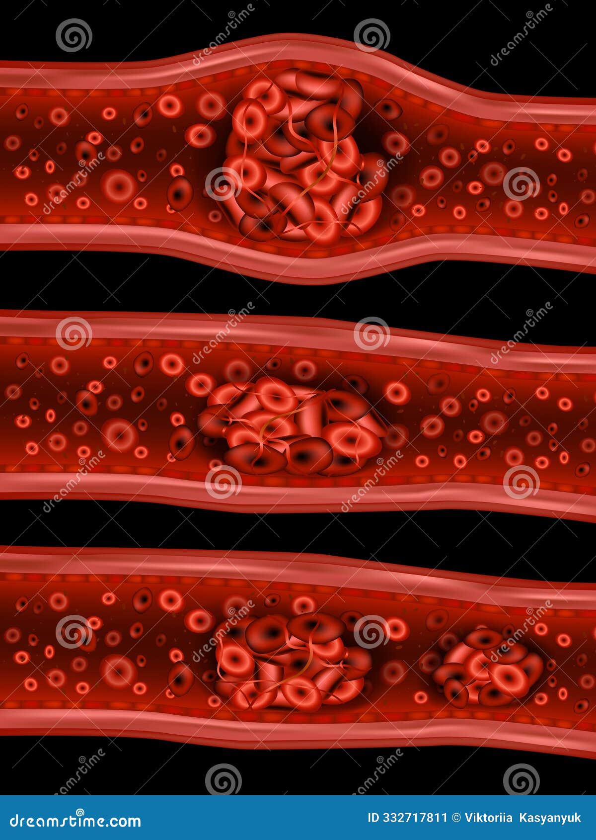 Illustration of the Thrombus Types. Types of Blood Clots Stock Vector ...