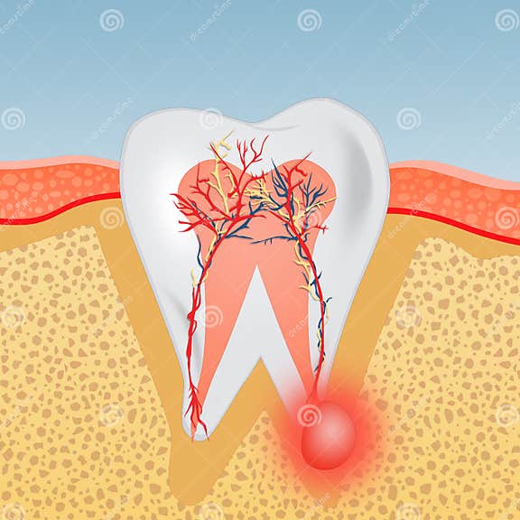 Tooth with abscess stock illustration. Illustration of oral - 129977447