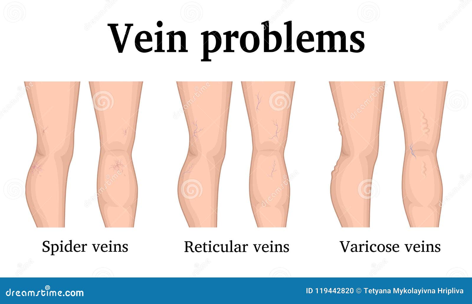 Venous Problems. Infographic Template Of Venous Disease Blood Scheme ...