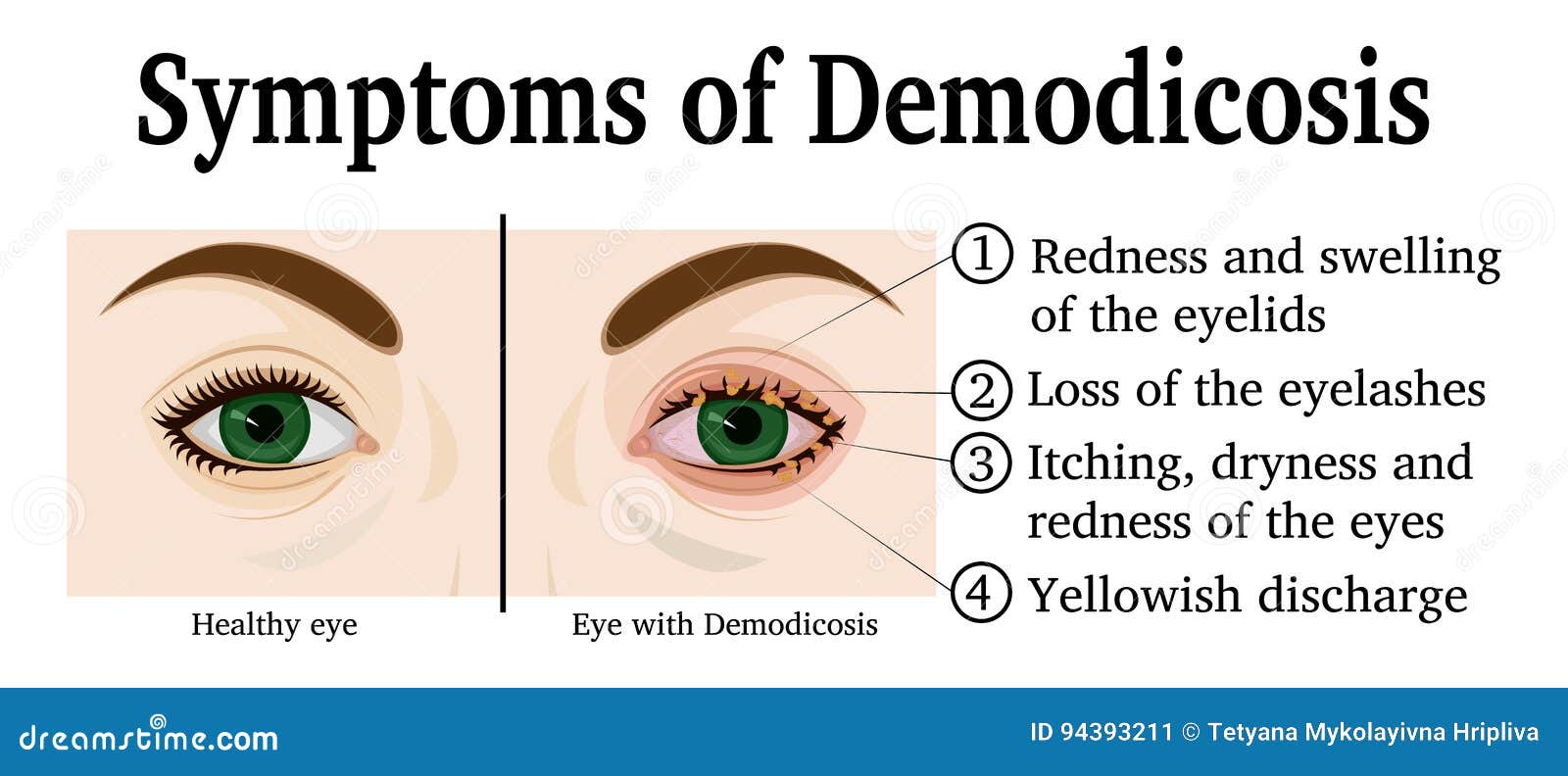 Illustration Von Demodicosis Vektor Abbildung - Illustration von ...