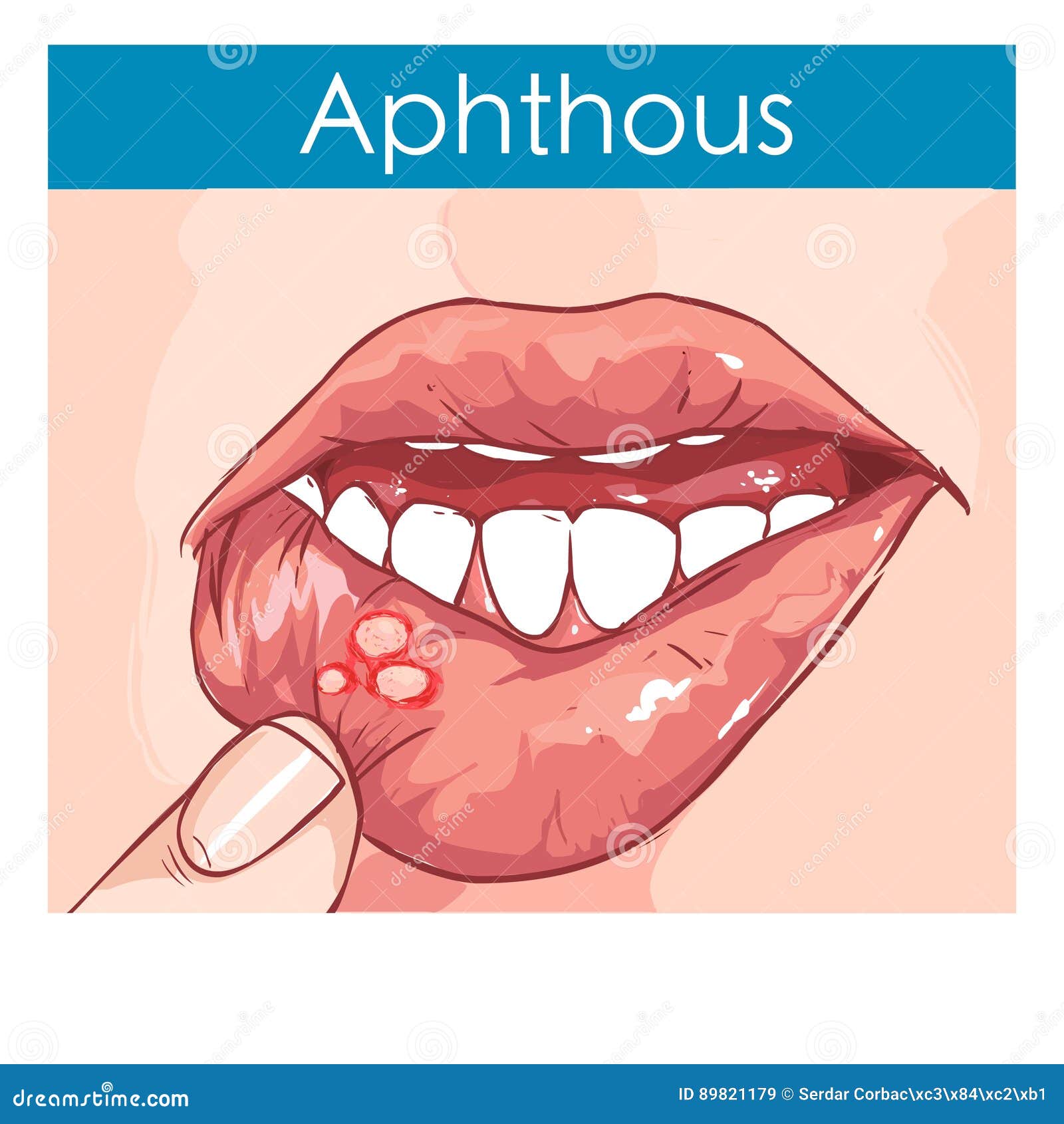 Illustration of a Woman with Aphthae on Lip Stock Vector - Illustration ...