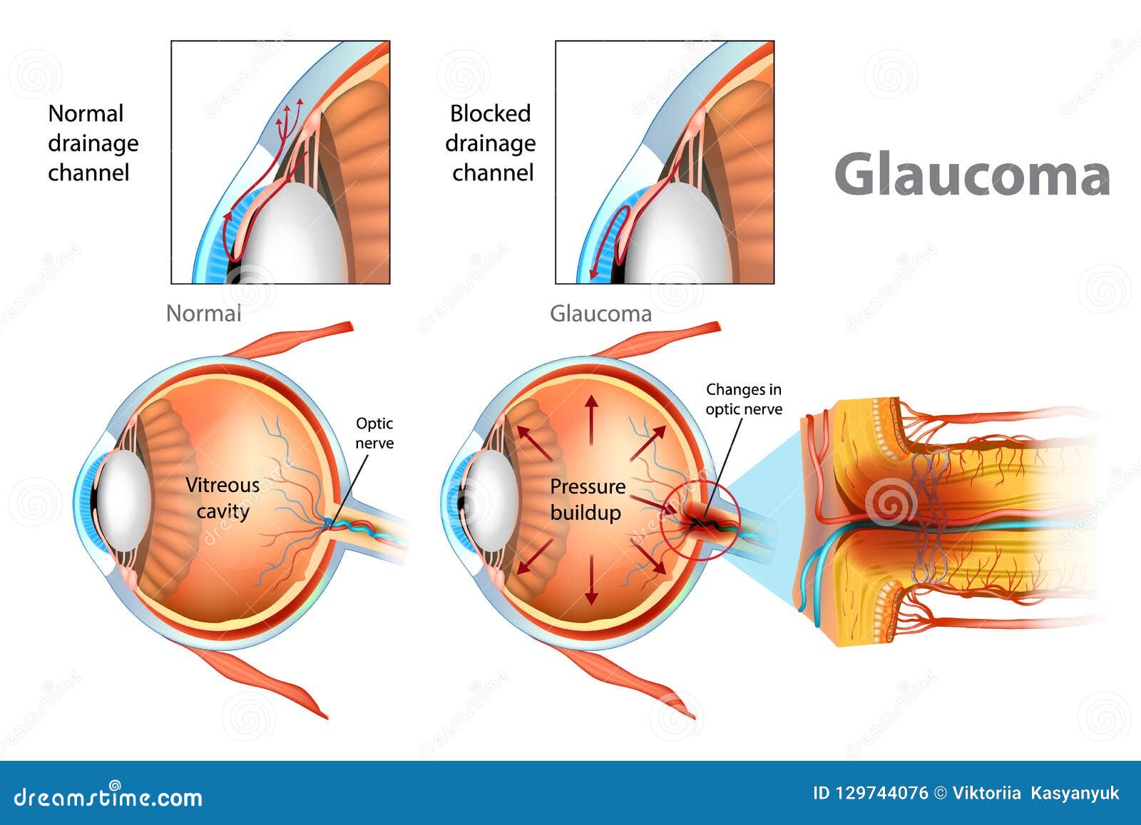 Illustrazione Che Mostra Glaucoma Ad Angolo Aperto Illustrazione ...