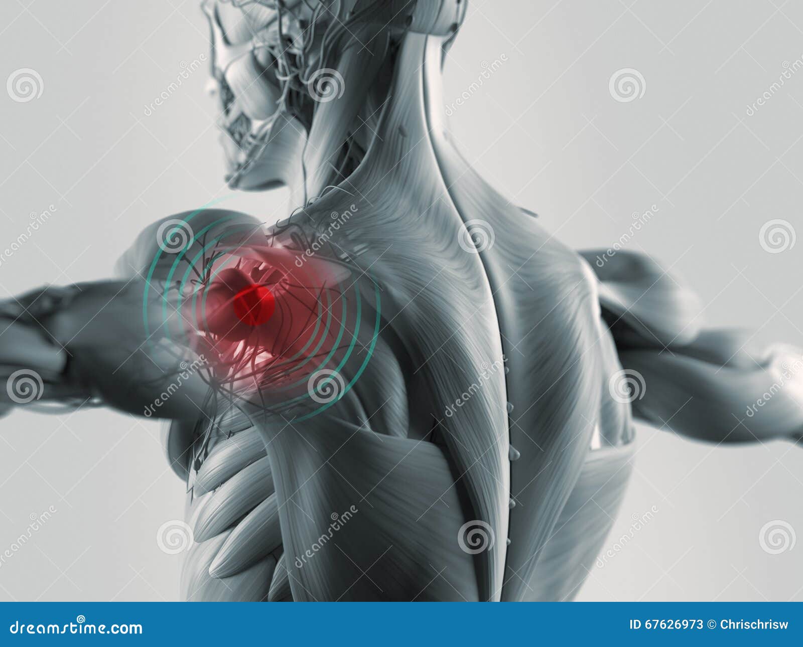 Illustrazione Di Dolore Della Spalla Immagine Stock - Immagine di ...