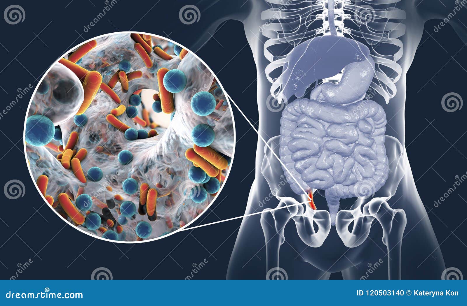Ilustração Da Apendicite Aguda Ilustração Stock - Ilustração de ...