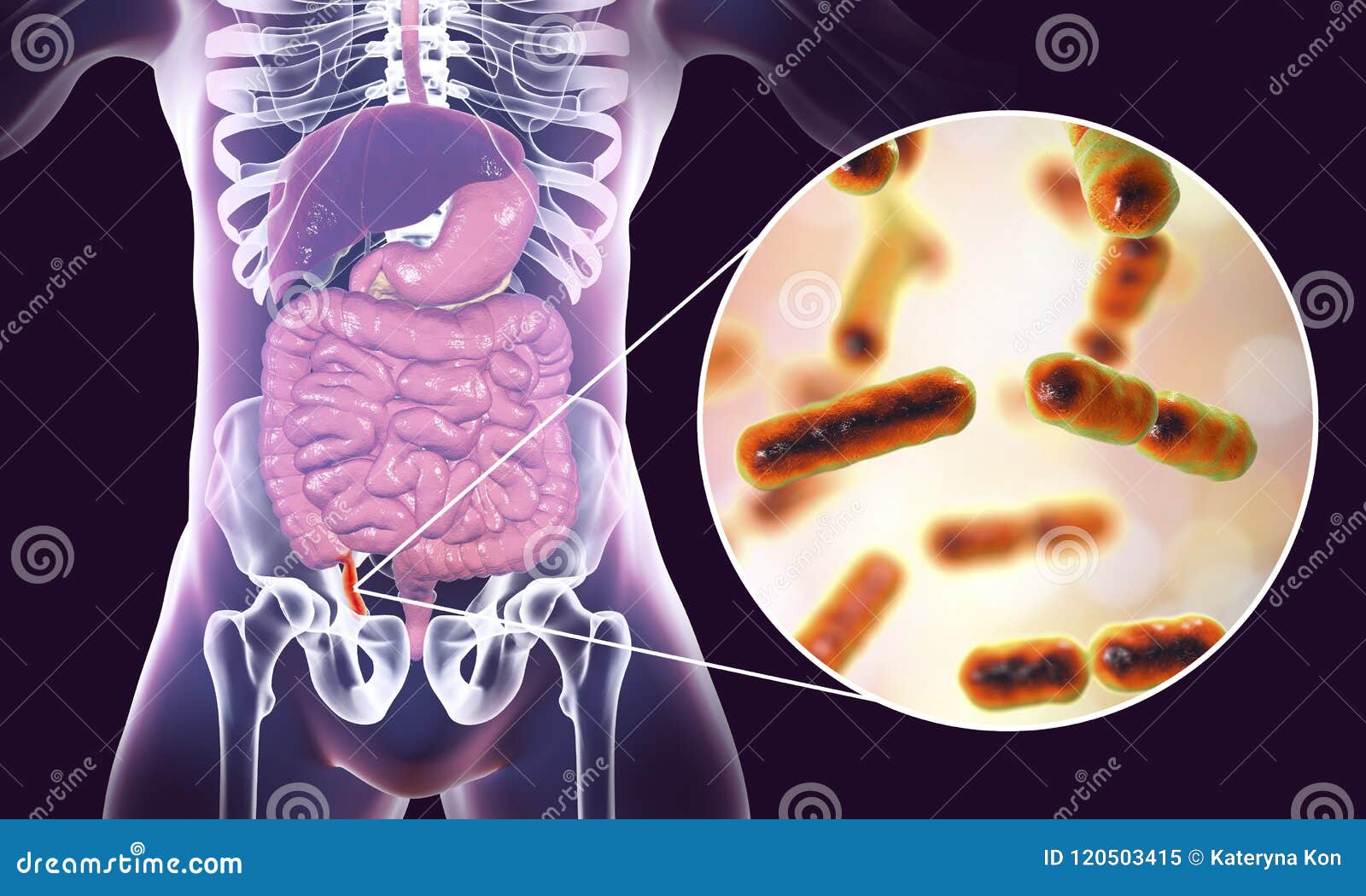 Ilustração Da Apendicite Aguda Ilustração Stock - Ilustração de ...