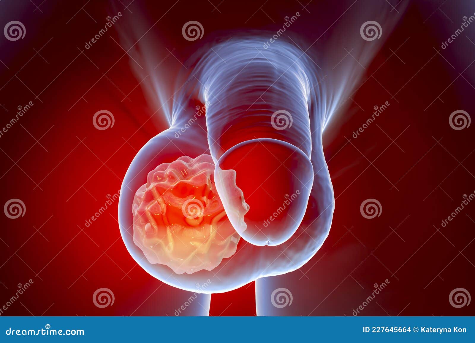 Ilustración 3d De Cáncer Testicular Stock De Ilustración Ilustración