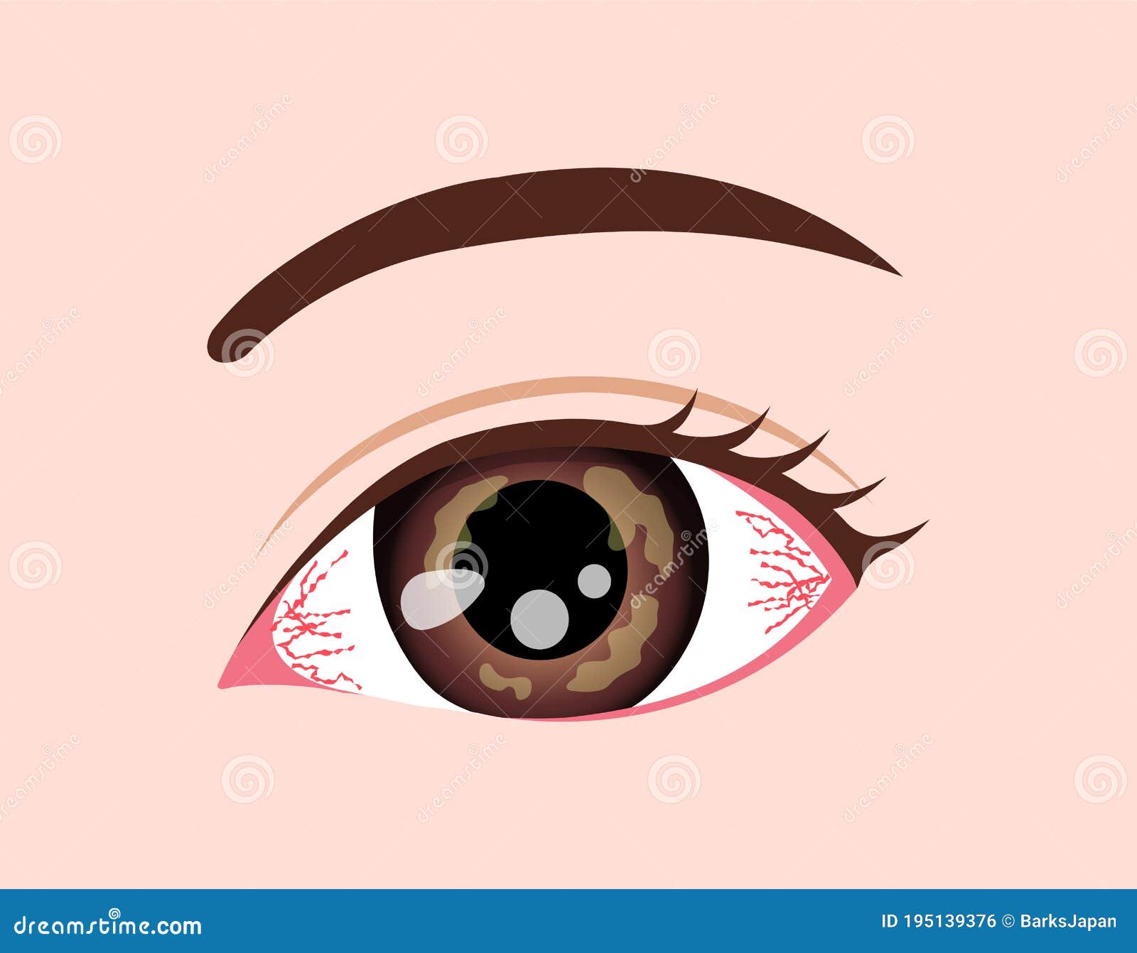 Ilustración Vectorial De Enfermedad Ocular Queratitis Herpética