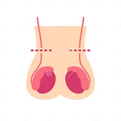 Ilustración Vectorial De Icono Plano De Vasectomía Ilustración del Vector - Ilustración de arte ...