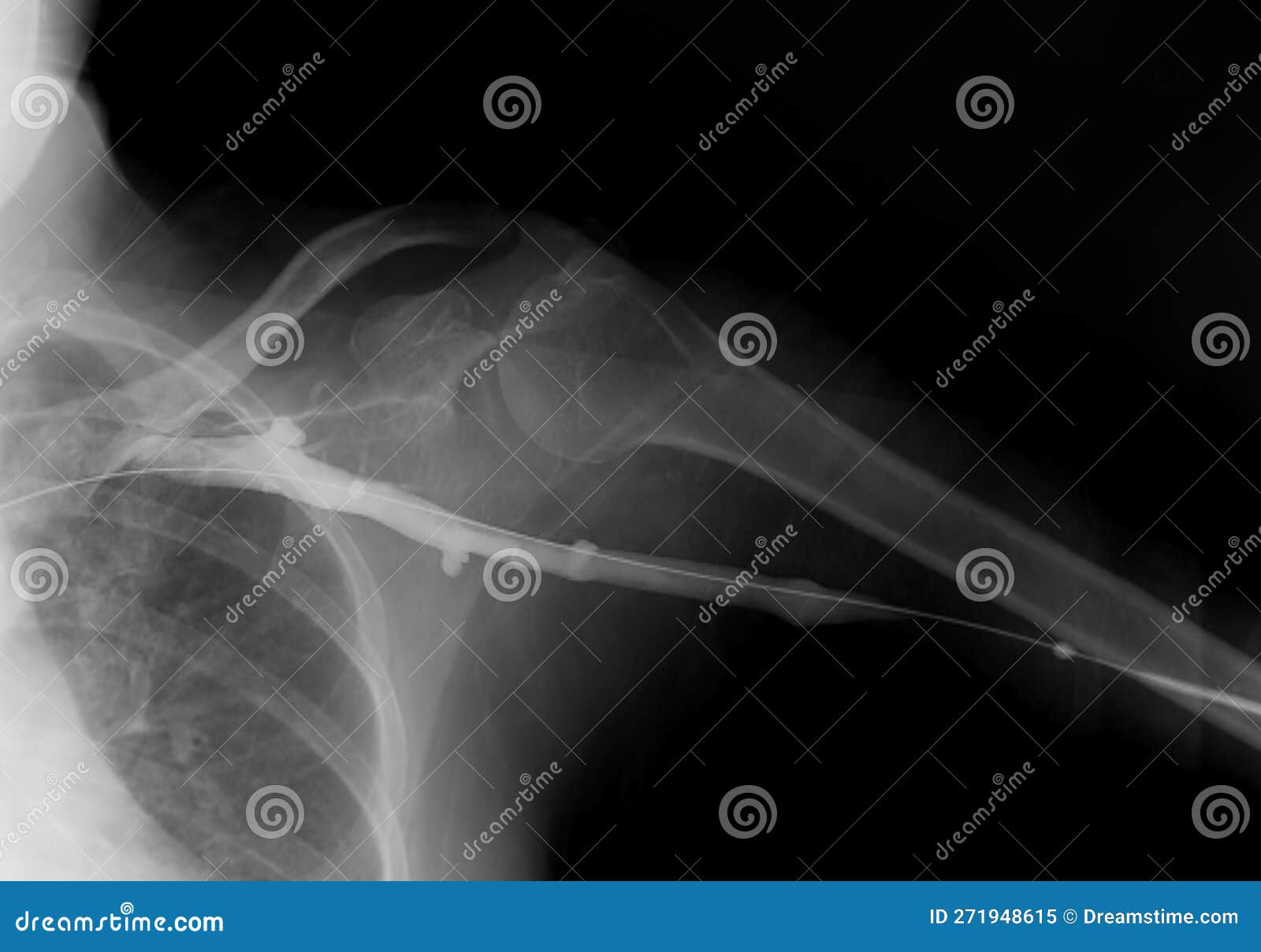 Image of Angioplasty, Balloon Angioplasty and Percutaneous Transluminal ...