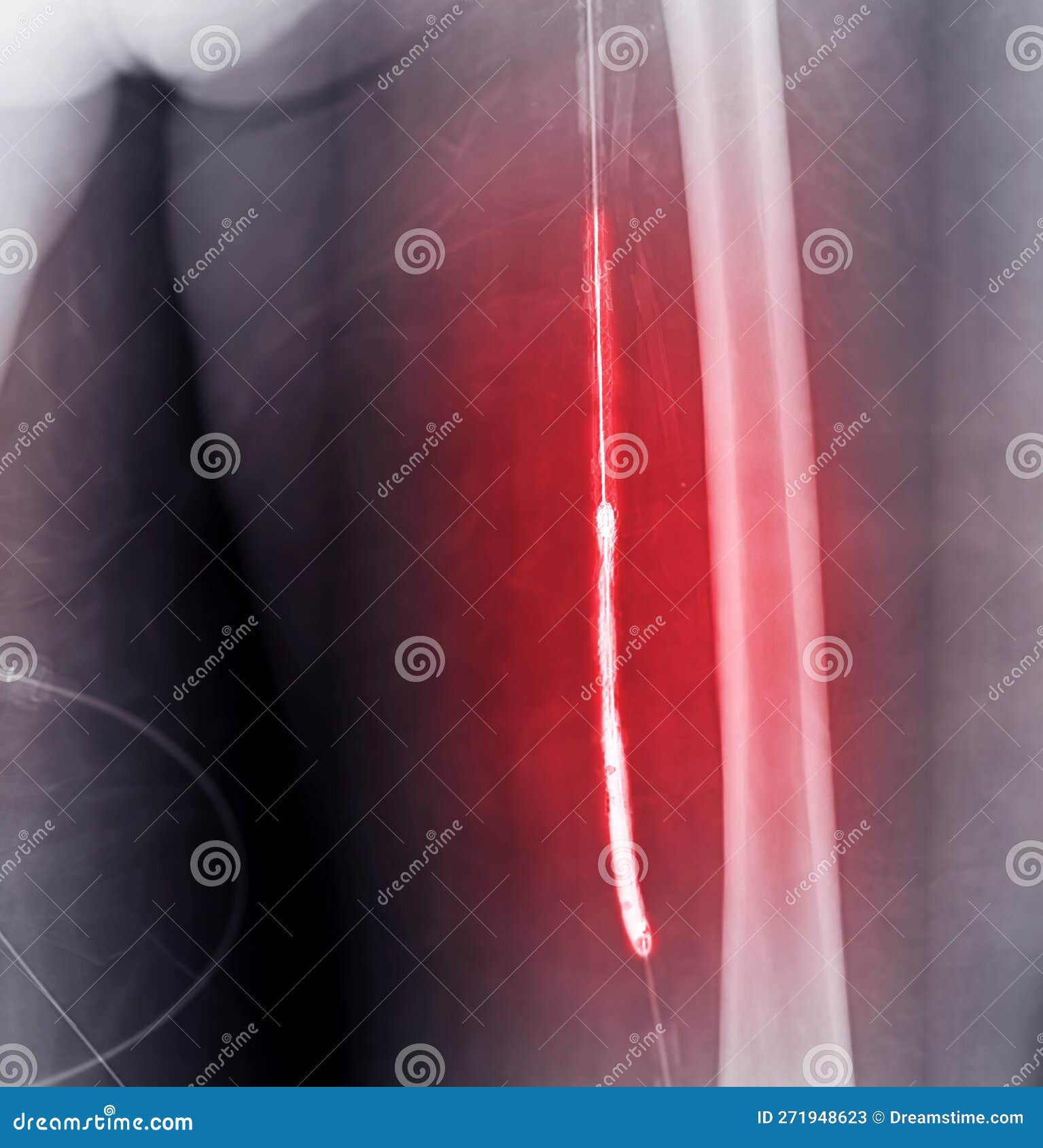 Image of Angioplasty, Balloon Angioplasty and Percutaneous Transluminal ...