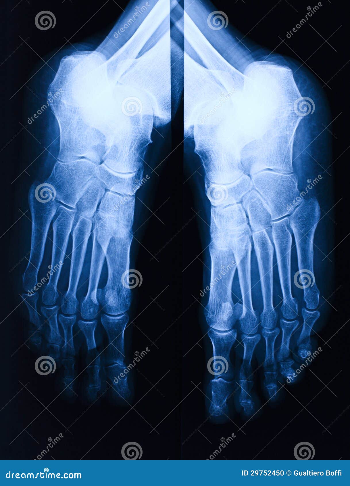 Foot Xray Anatomy