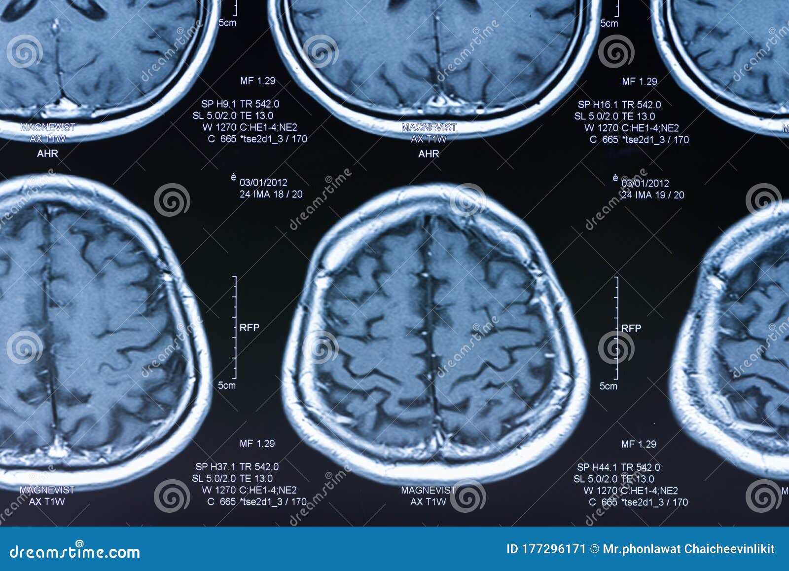 Brain ct scan stock image. Image of neurology, analyzing - 177296171