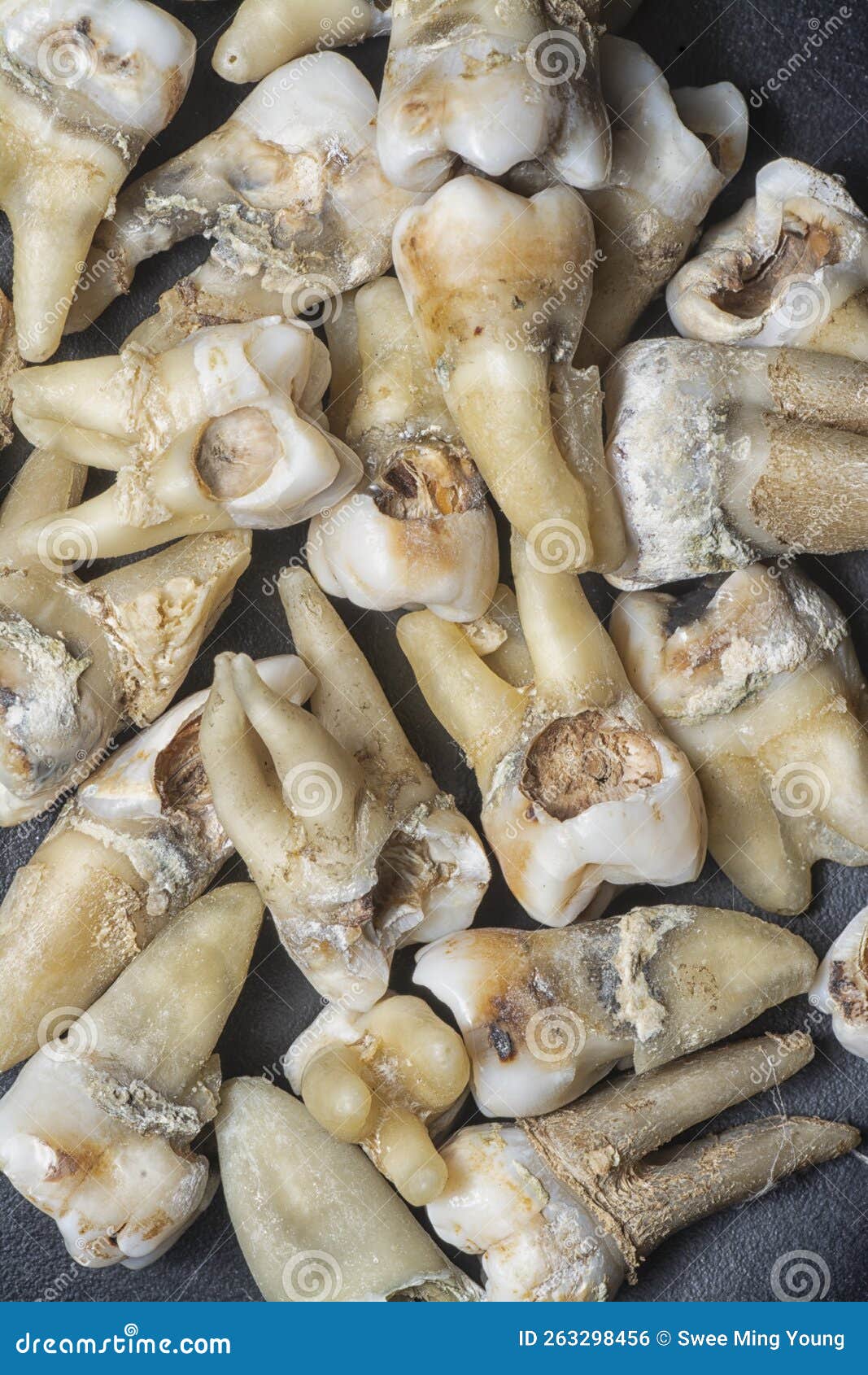 The Bundle of Unwanted Extracted Decay Human Teeth. Stock Photo - Image ...