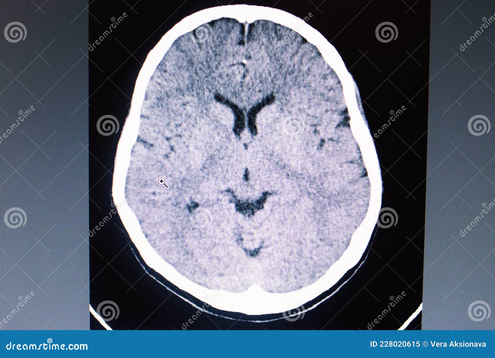 Image of Computed Tomography of the Brain Stock Image - Image of ...