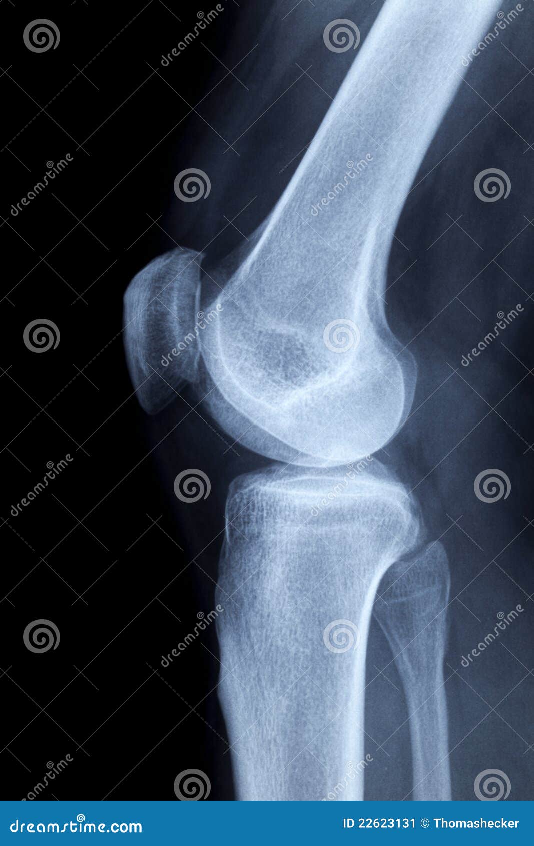 Image De Rayon X D'un Genou Humain Transversal Image stock - Image du ...