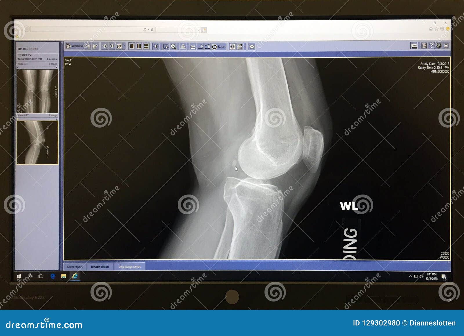 X-Ray of a Healthy Knee Bone on a Computer Screen Stock Photo - Image ...