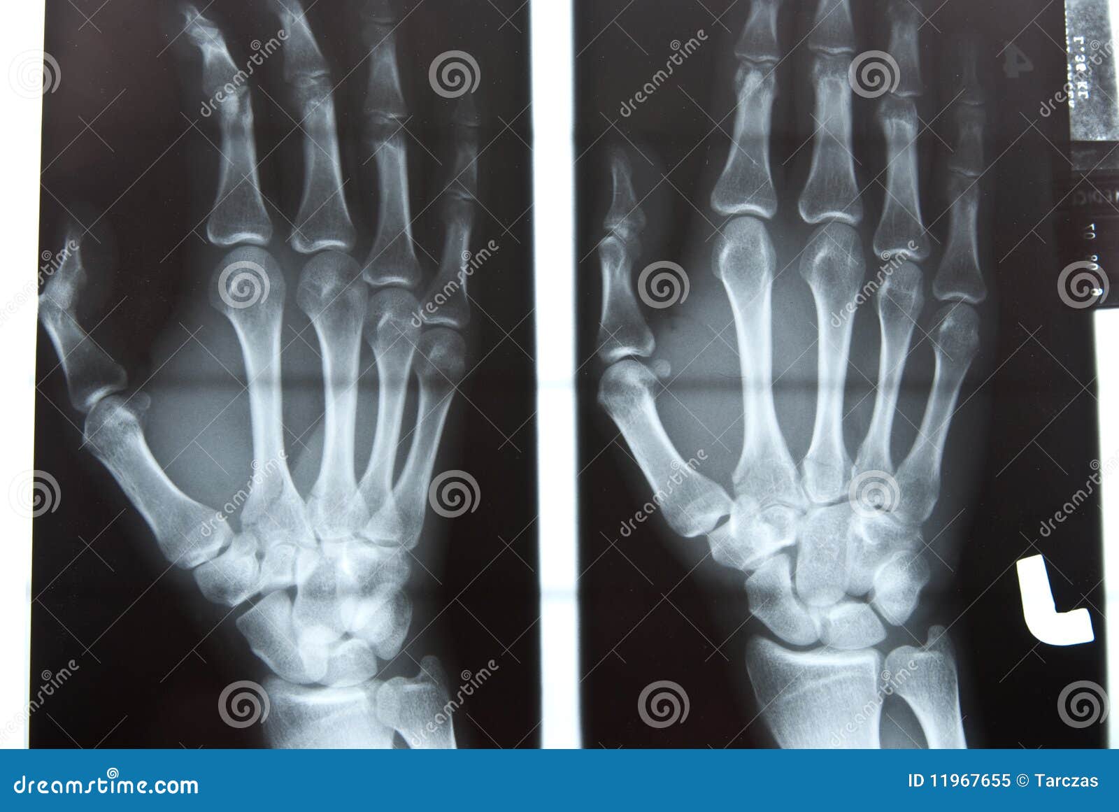 Image Humaine De Rayon X De Main Gauche Image stock - Image du soin ...