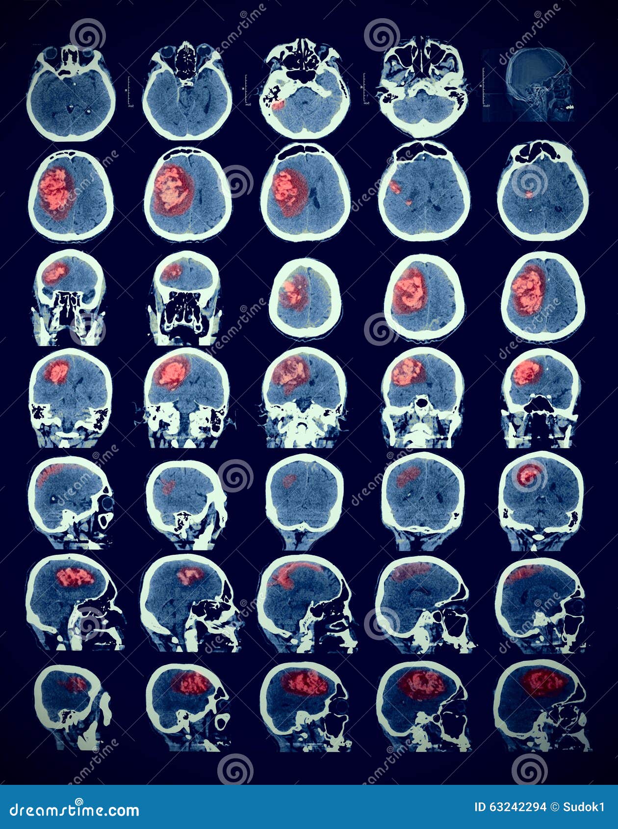 Image of the Human Brain with the Pathology Stock Illustration ...