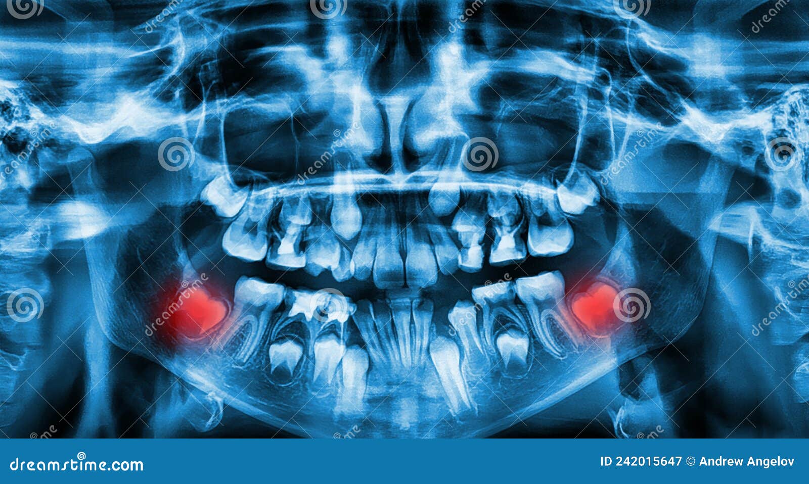 Image Panoramique Des Dents Image stock - Image du docteur, dentaire ...
