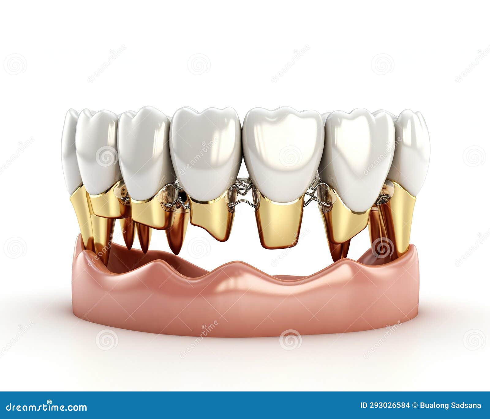 The Lower Jaw Has a Dental Post and Core Tooth Restoration. Stock ...