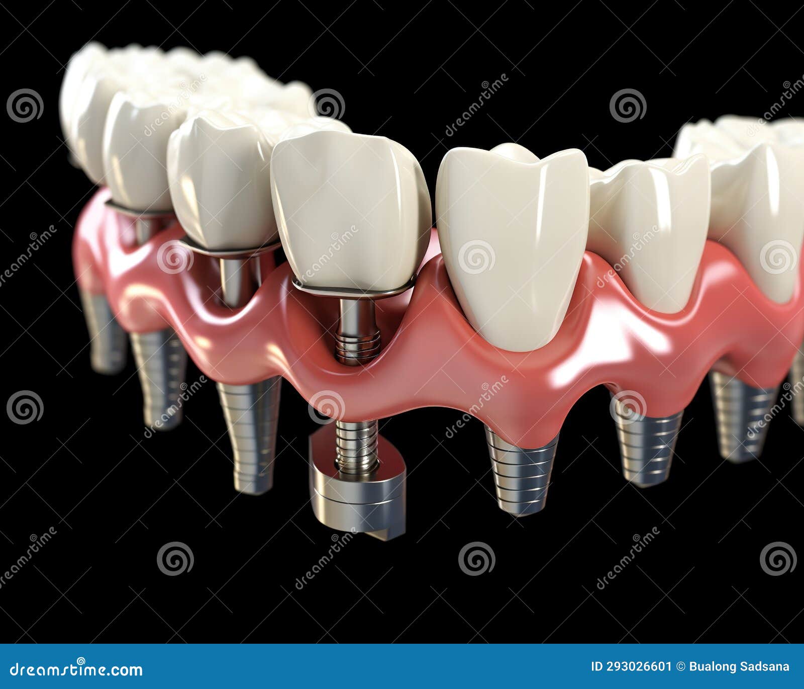 The Lower Jaw Has a Dental Post and Core Tooth Restoration. Stock ...