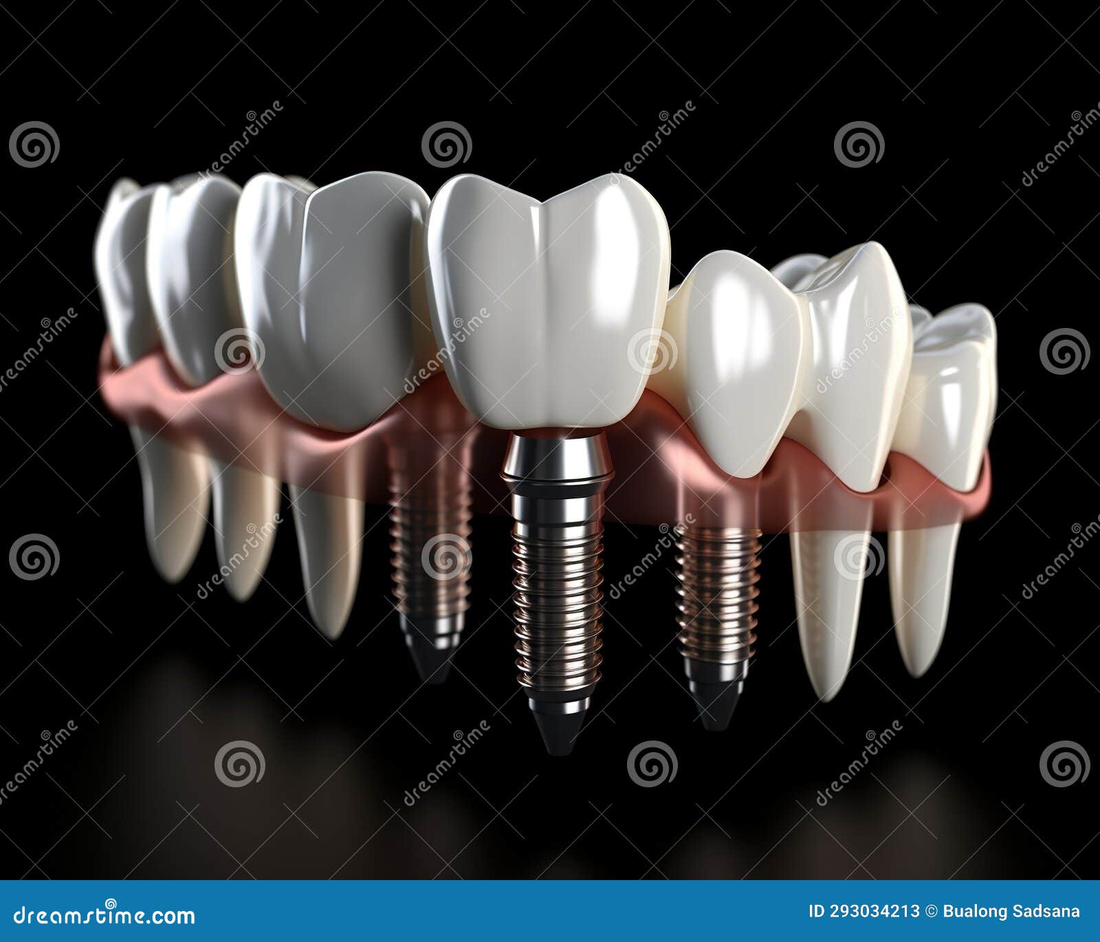 The Lower Jaw Has a Post and Core Tooth Restoration. Stock Illustration ...